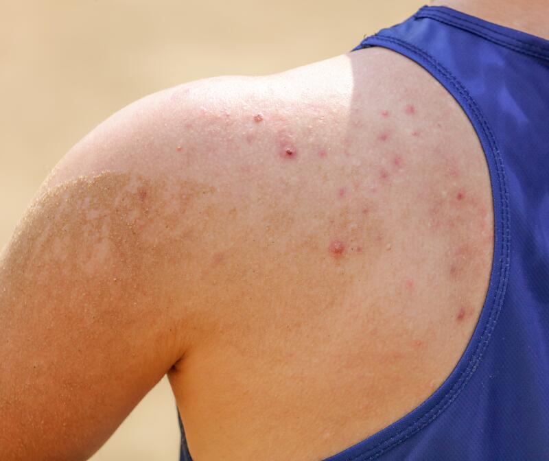 L’acné dans le dos | Laboratoires Dermatologiques Ducray