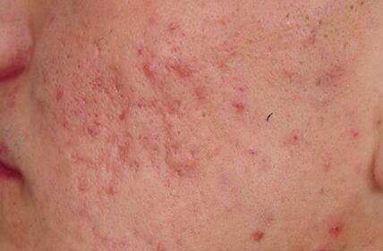 Littekens door acne | Ducray