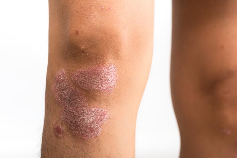Is psoriasis an autoimmune disease? | Ducray