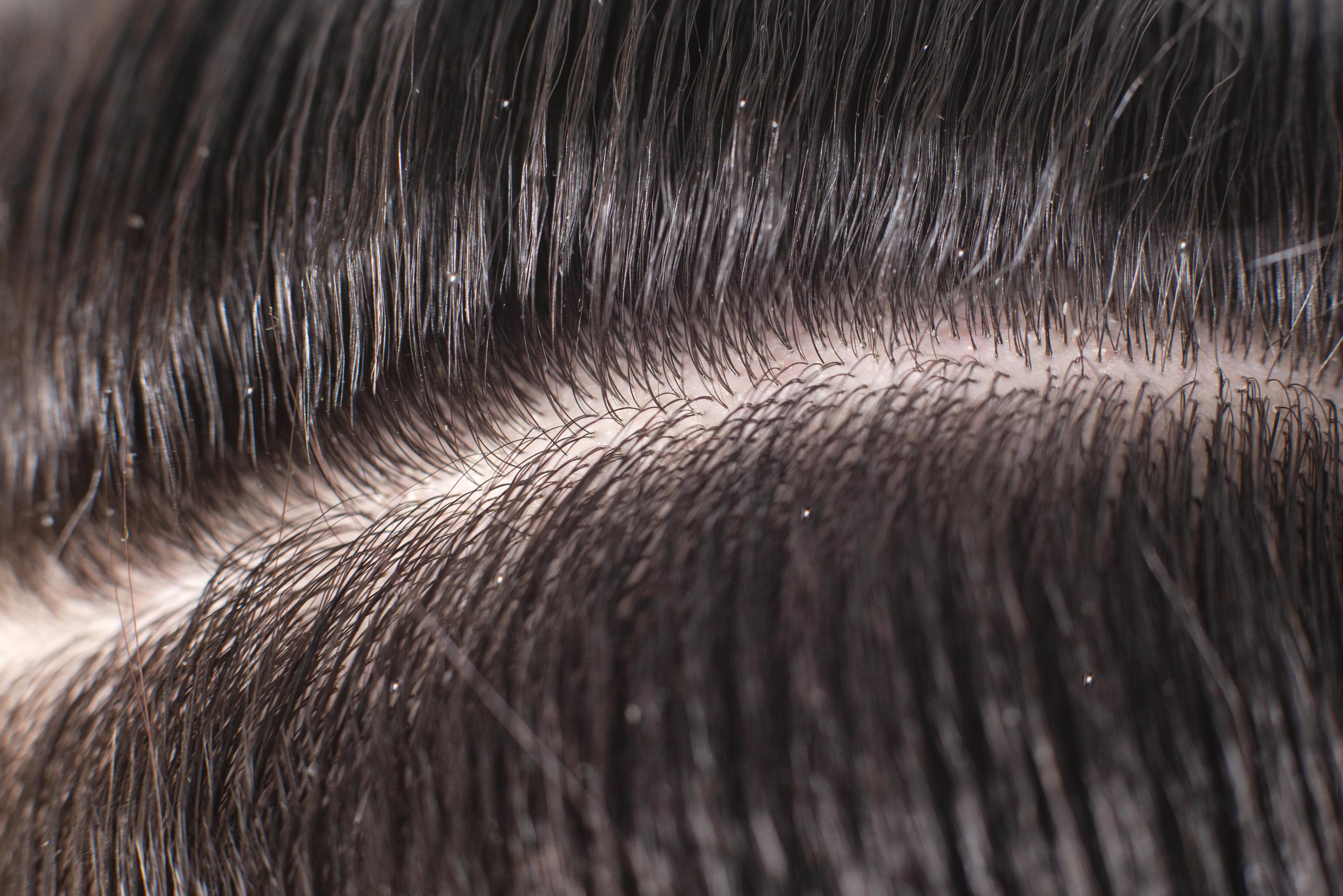 Vette hoofdhuid, hoe te behandelen en te verzorgen?