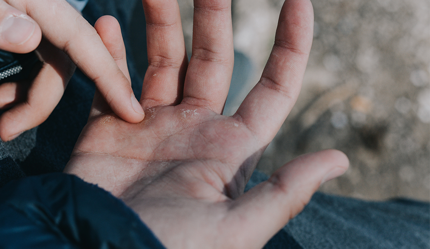 Juckende Hand, Finger: Wie kann man sie lindern? | Ducray