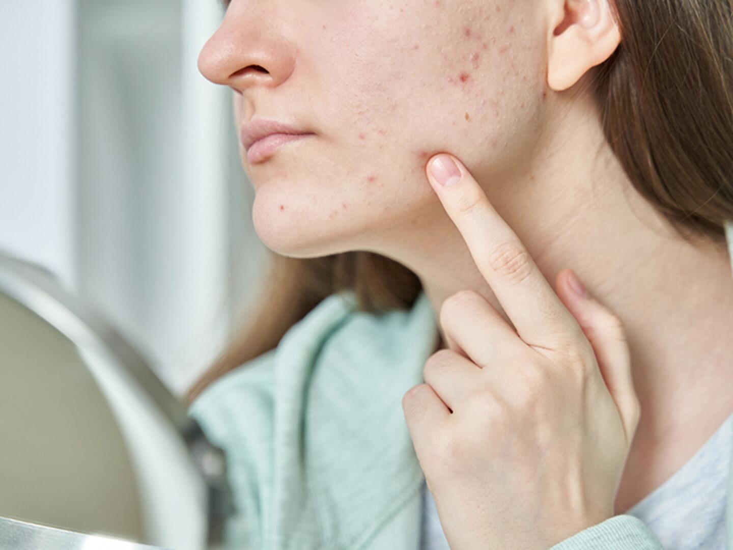 Acne conglobata | Eau Thermale Avène