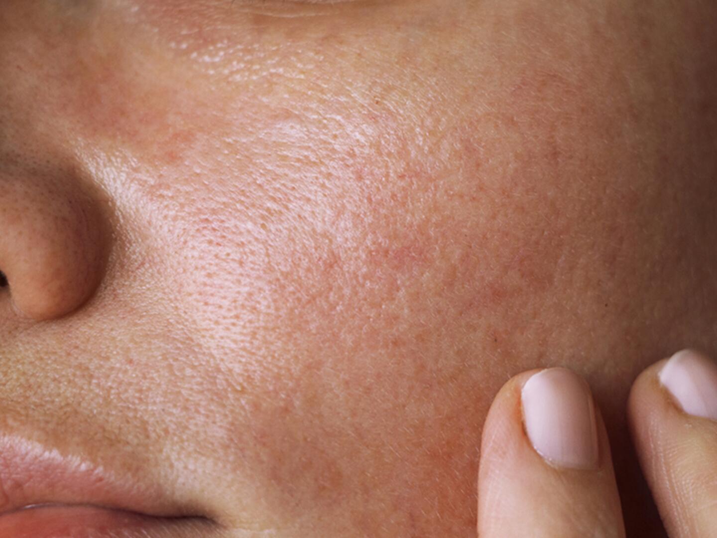 Fettige Haut richtig pflegen | Hautexperten | Eau Thermale Avène