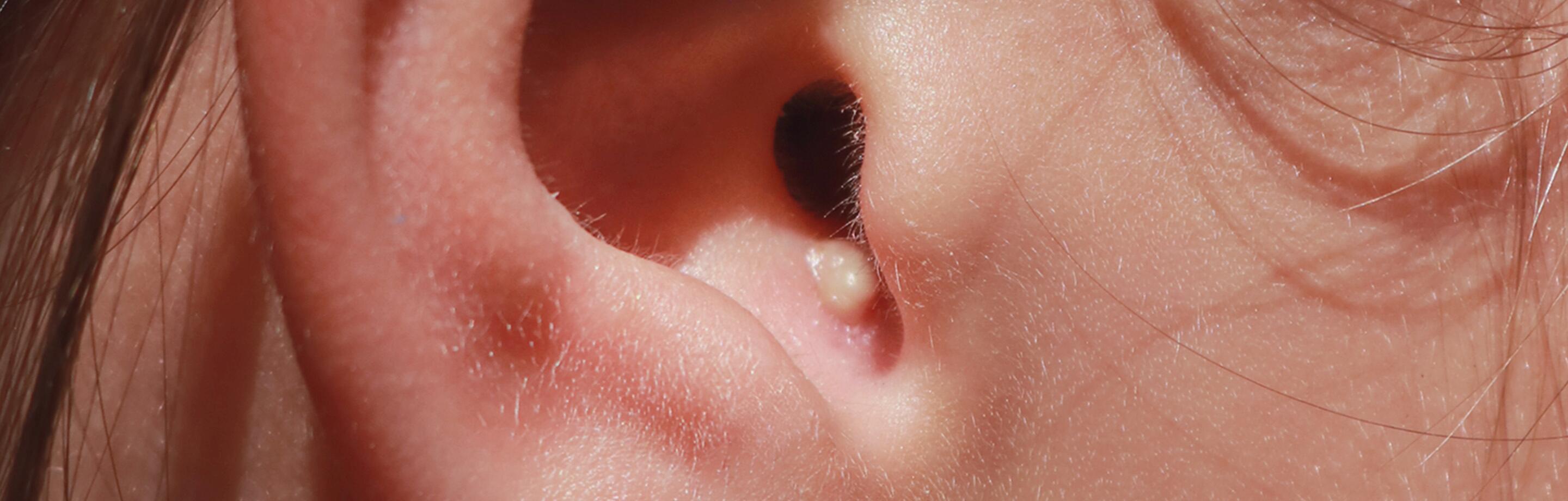 Pickel im Ohr | Eau Thermale Avène