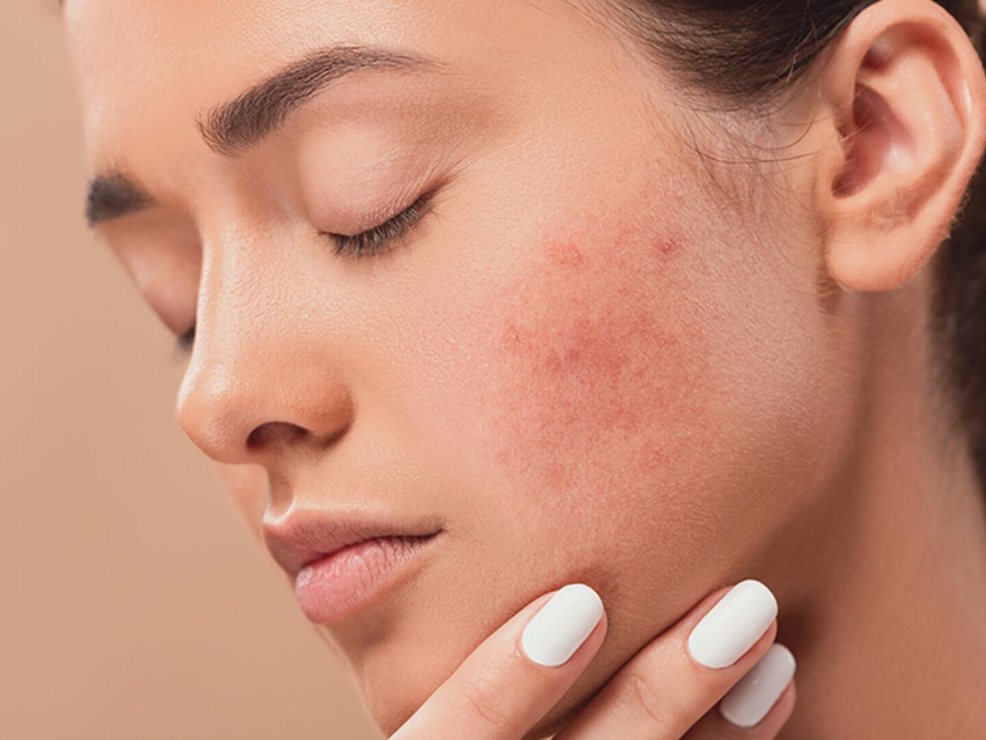 Die verschiedenen Akne Arten | Eau Thermale Avène