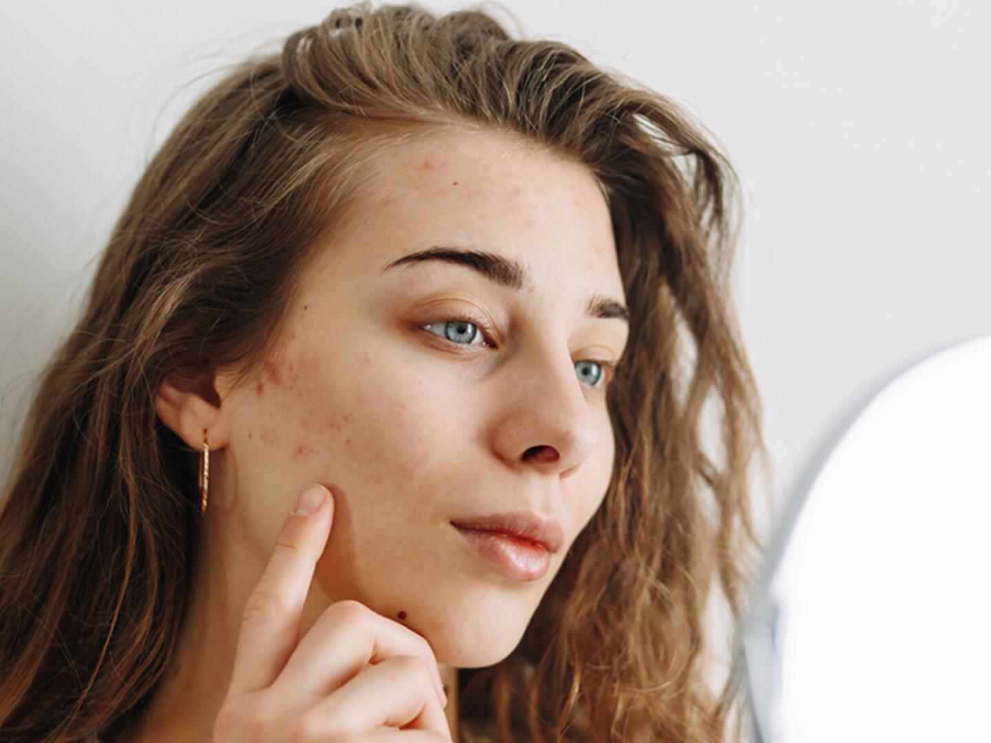 Acne conglobata | Eau Thermale Avène