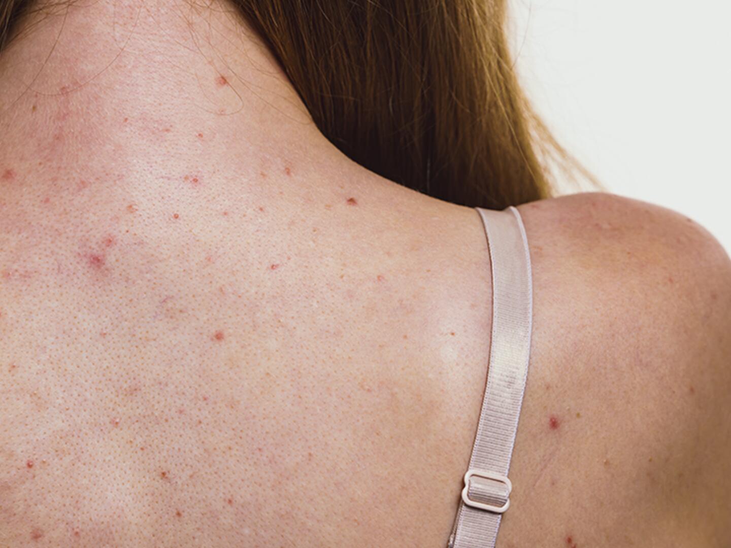 Akne Rücken und Schultern | Eau Thermale Avène