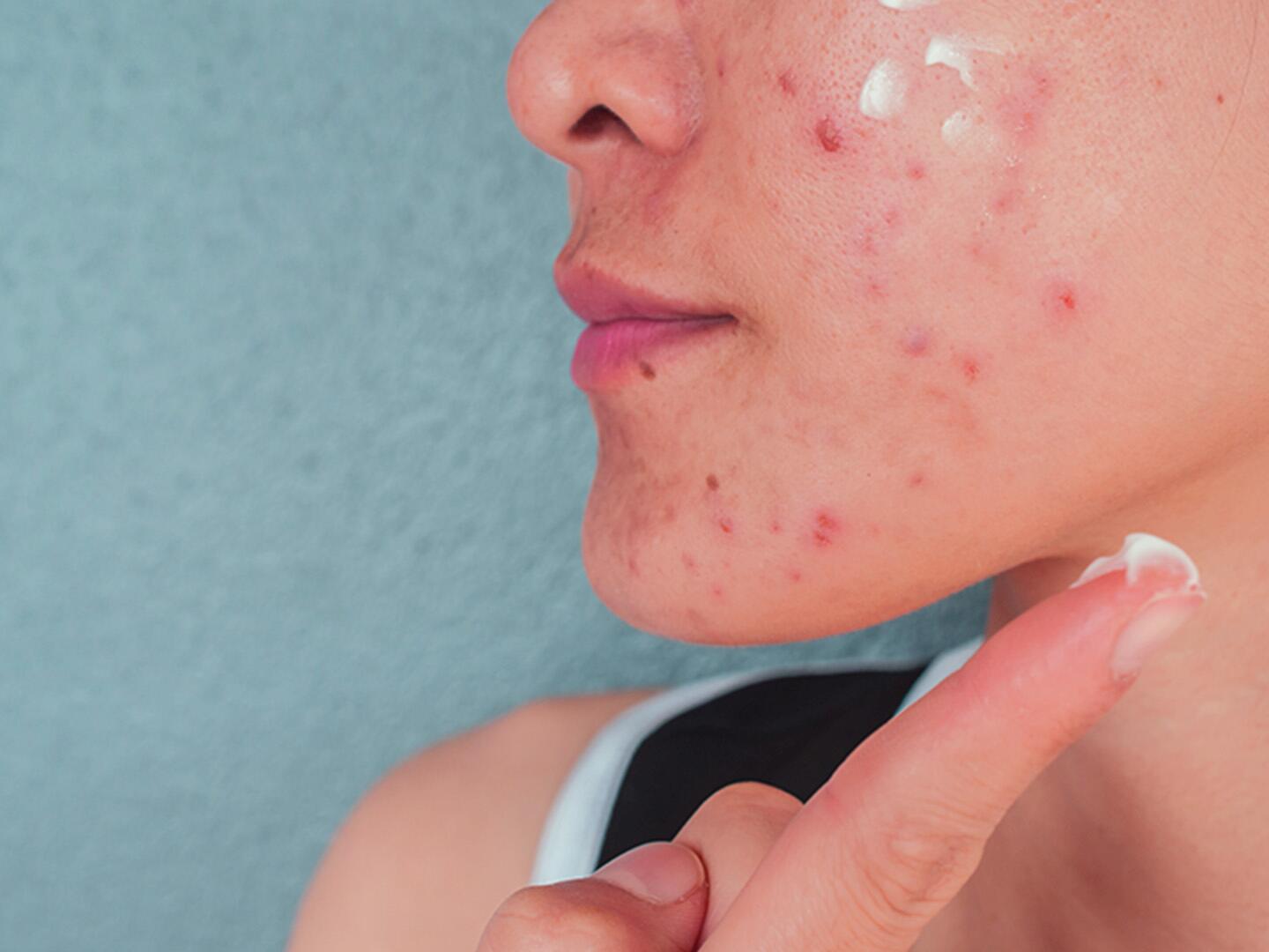 Akne Creme | Effektiv gegen Pickel | Eau Thermale Avène