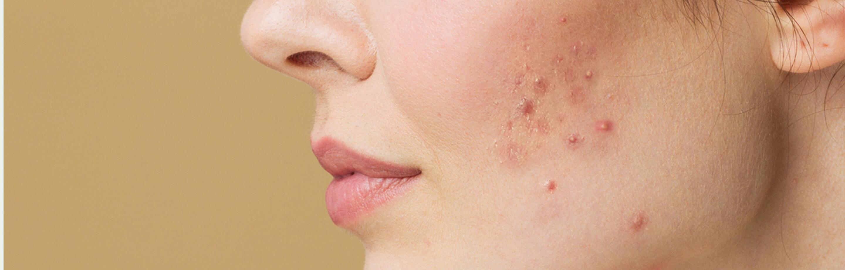 Akne vulgaris – die häufigste Akneform | Eau Thermale Avène