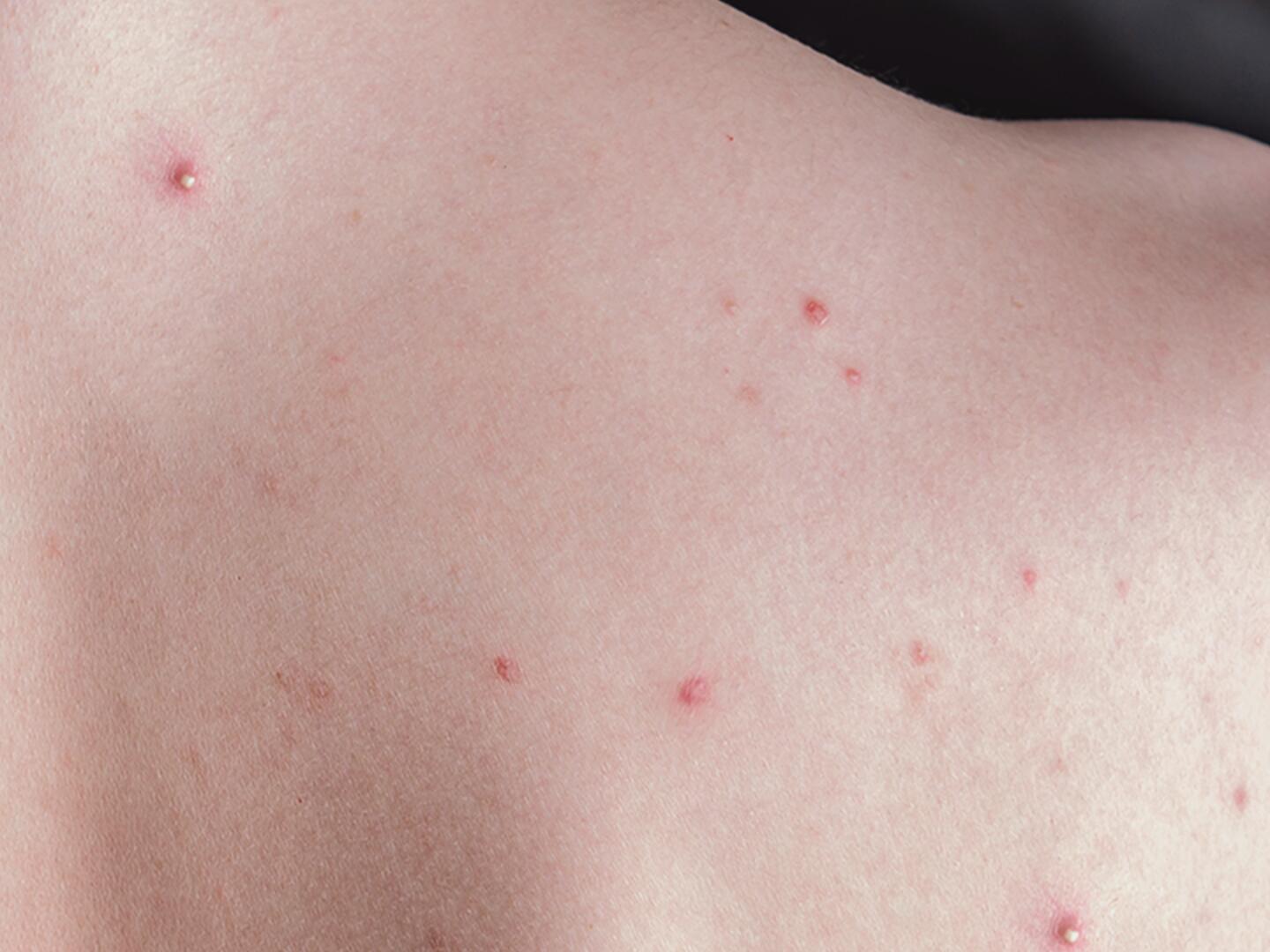 Akne Rücken und Schultern | Eau Thermale Avène