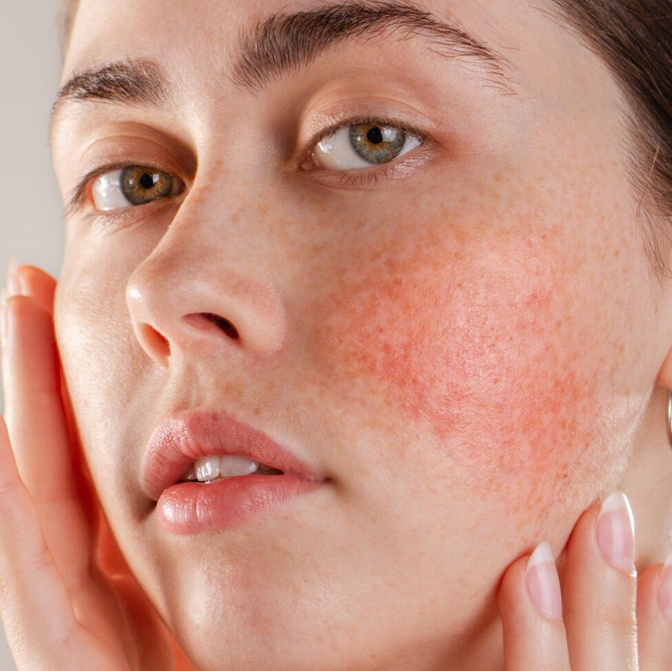 Ansigtseksem: Årsager, symptomer og behandling | A-DERMA