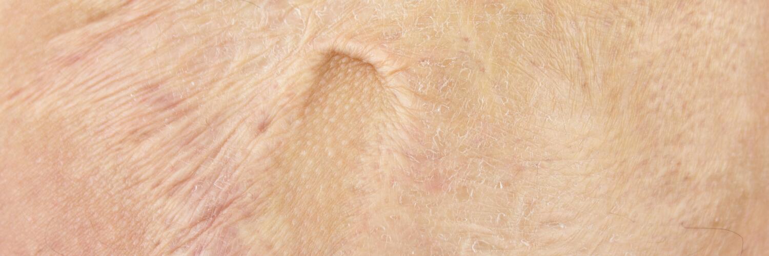 Cicatrice brûlure : Traitements et Conseils efficaces