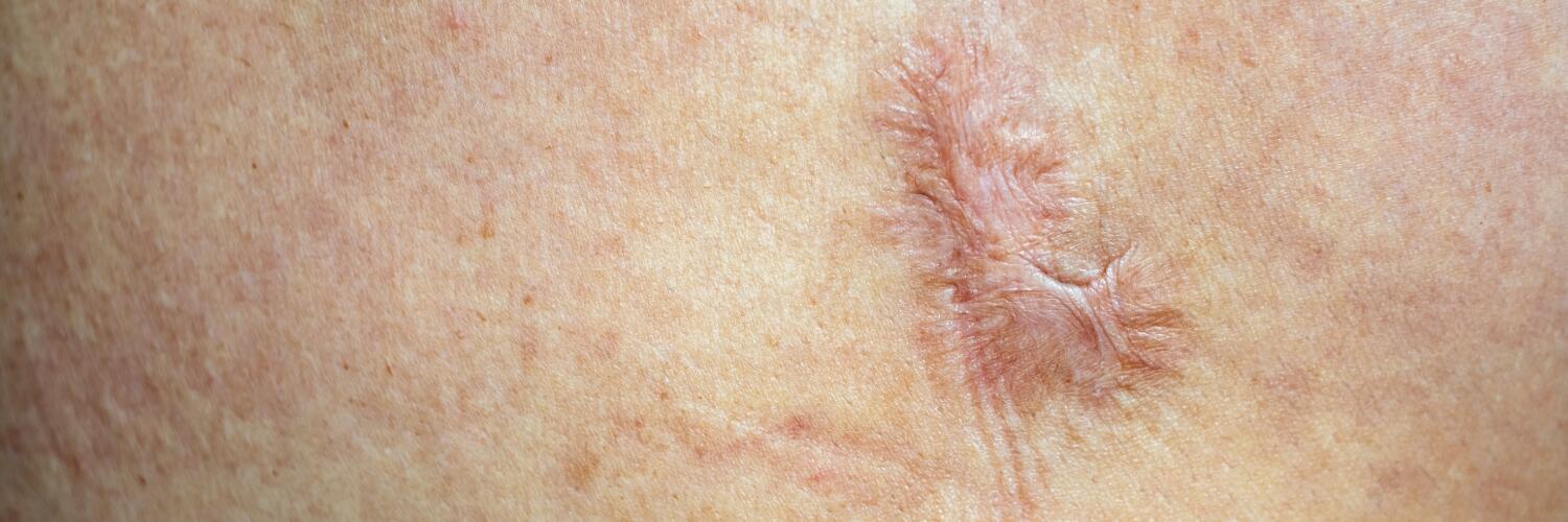 Cicatrice Chéloïde : Causes, Symptômes, Traitements