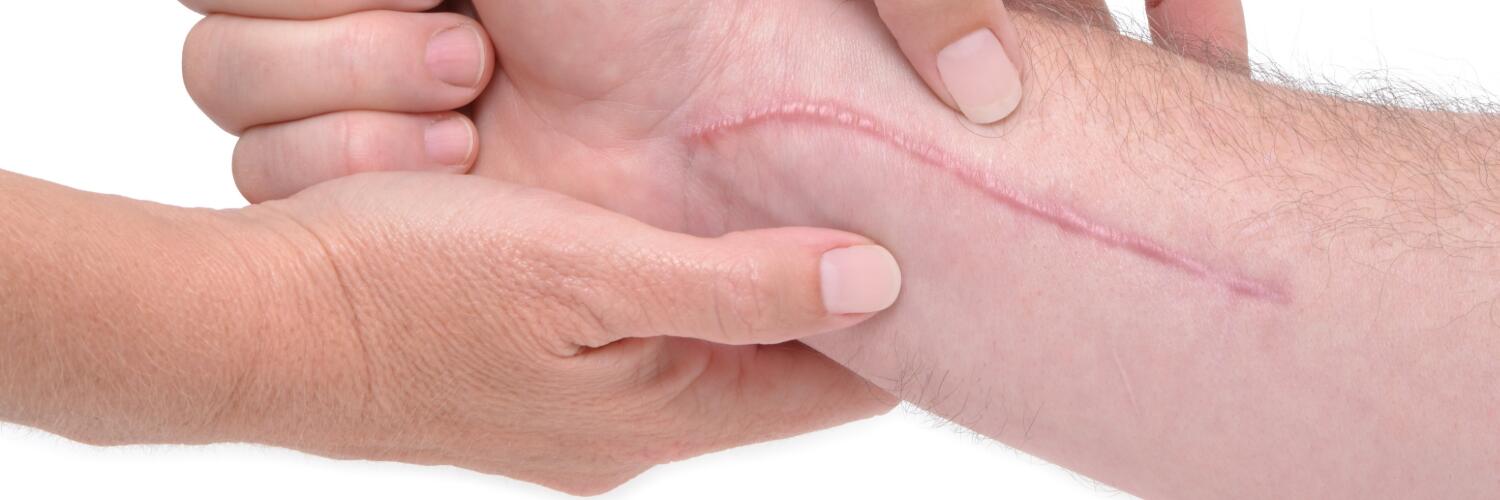 Cicatrice Hypertrophique : Symptômes et Traitements