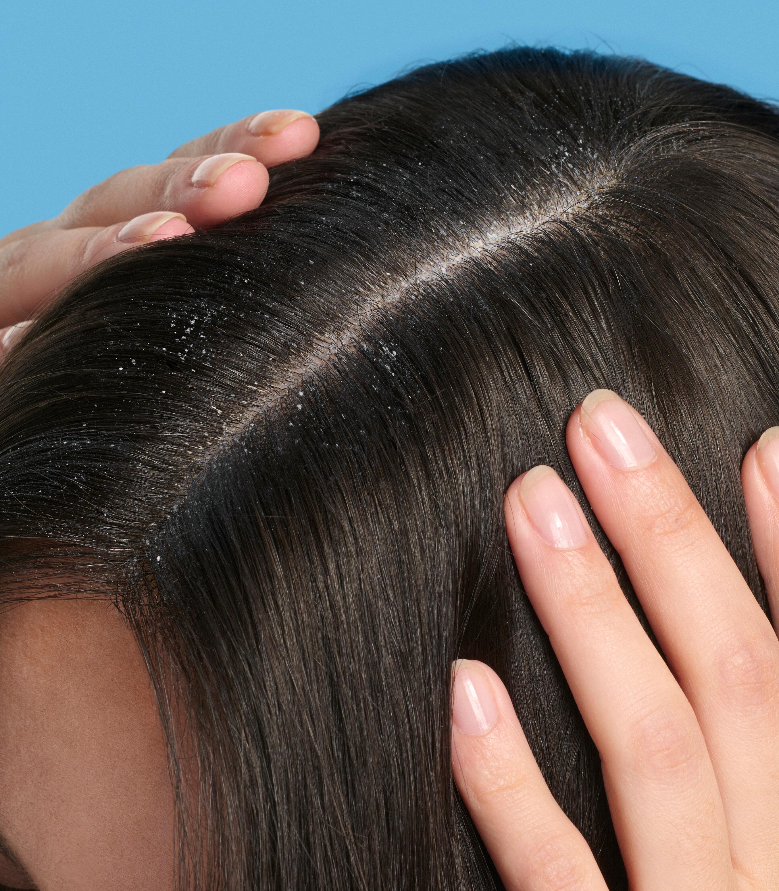 La psoriasis en la cara | Ducray