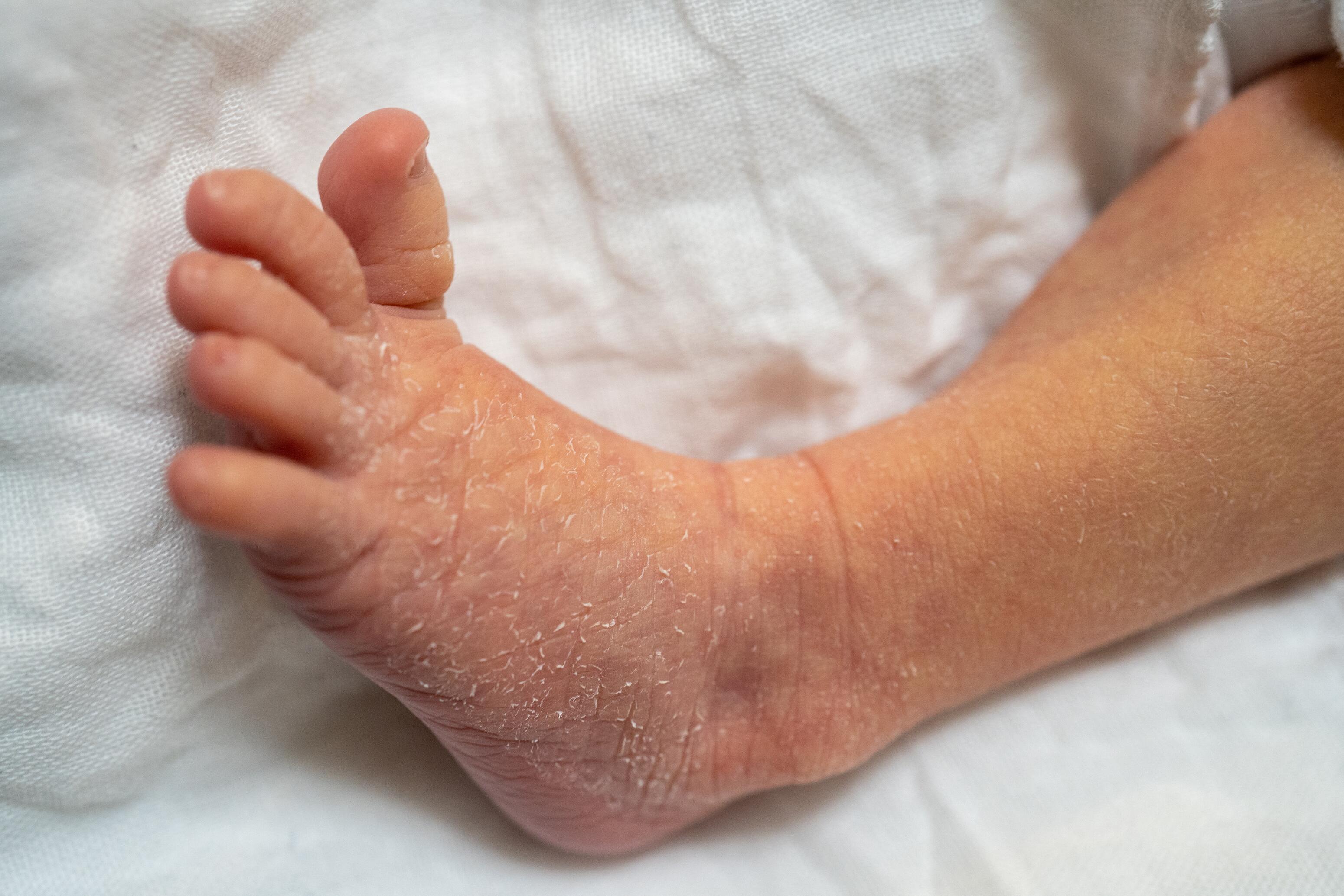 Eczema en bebés: síntomas, causas y tratamientos