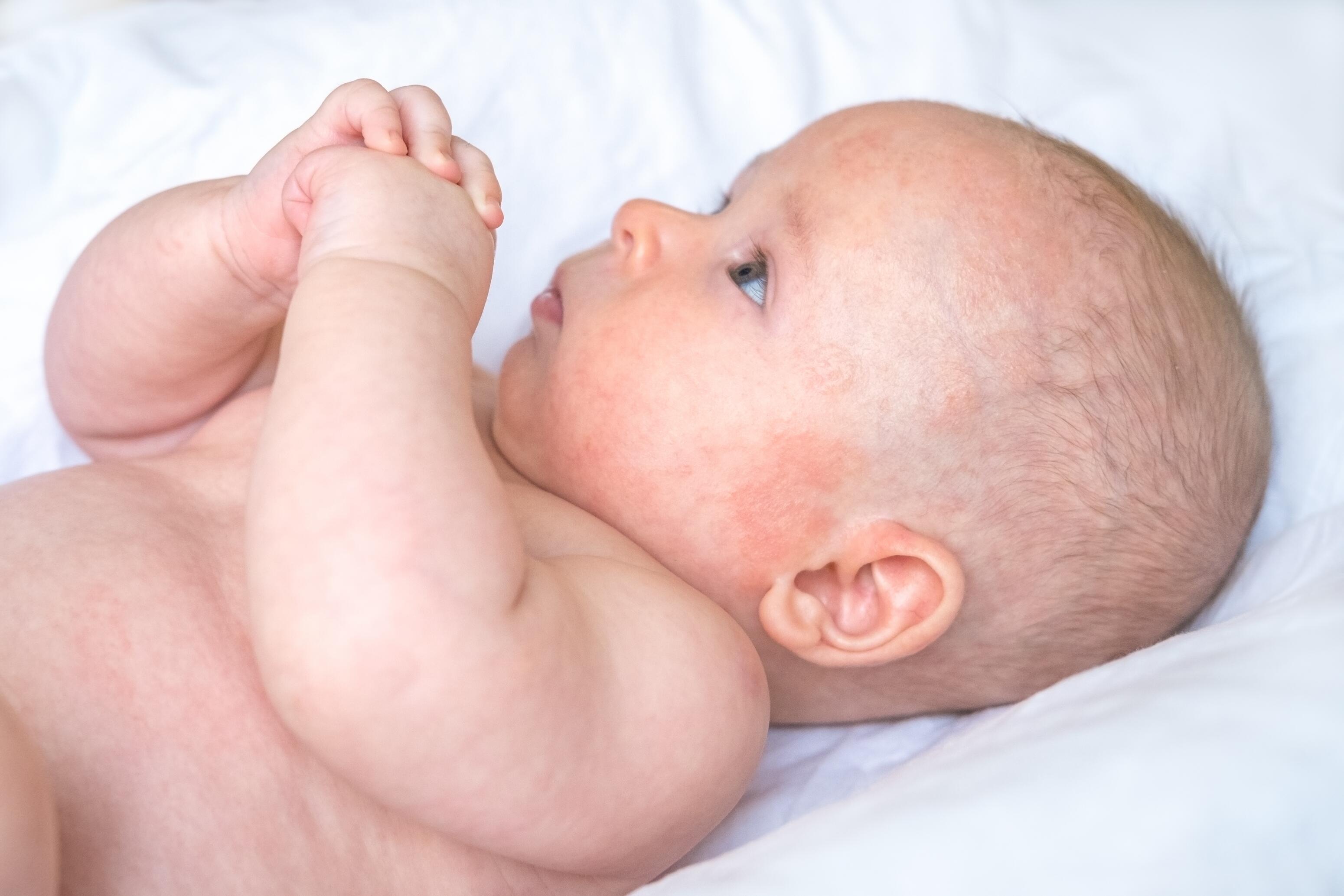 Eczema en bebés: síntomas, causas y tratamientos