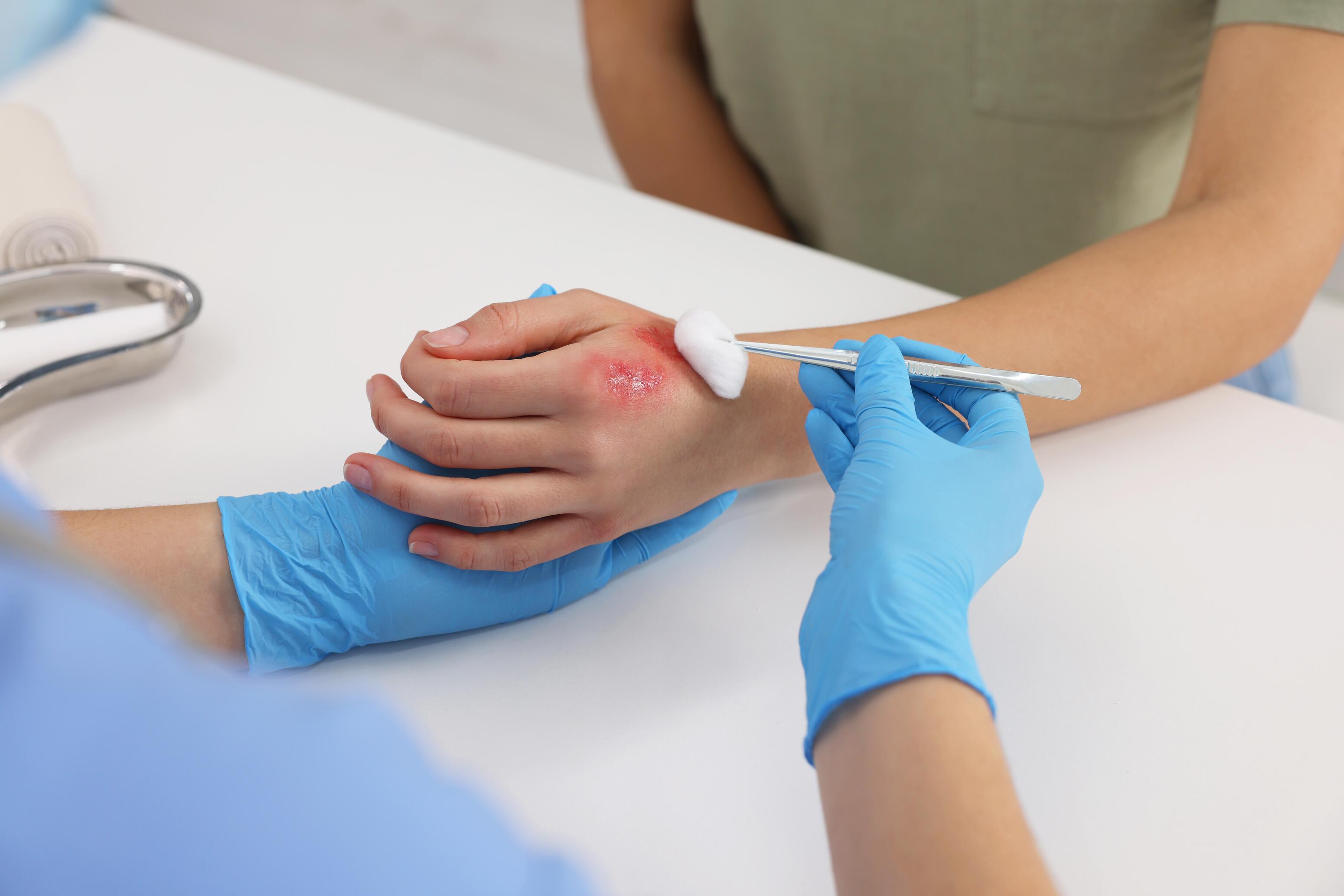 Désinfecter une plaie : Guide complet et conseils