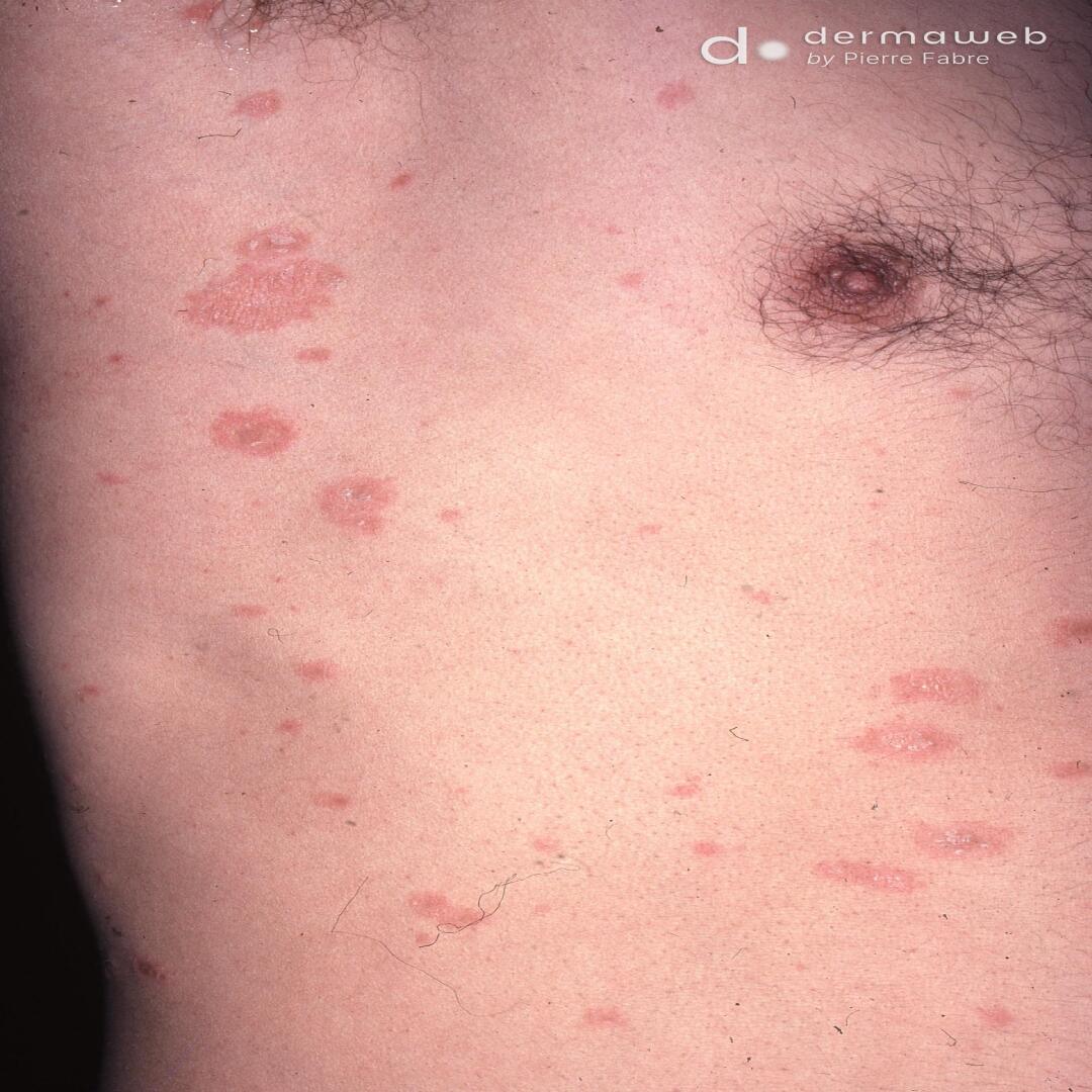 Treating dry patches of skin on the body: A complete guide