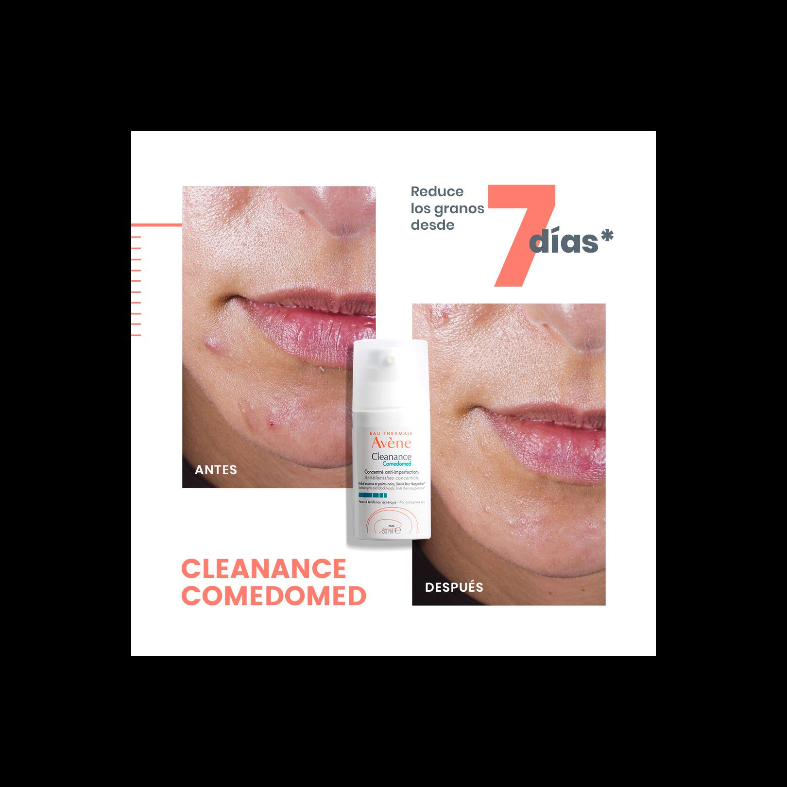 Cleanance Comedomed, elimina los granos y frena su reaparición | Eau ...