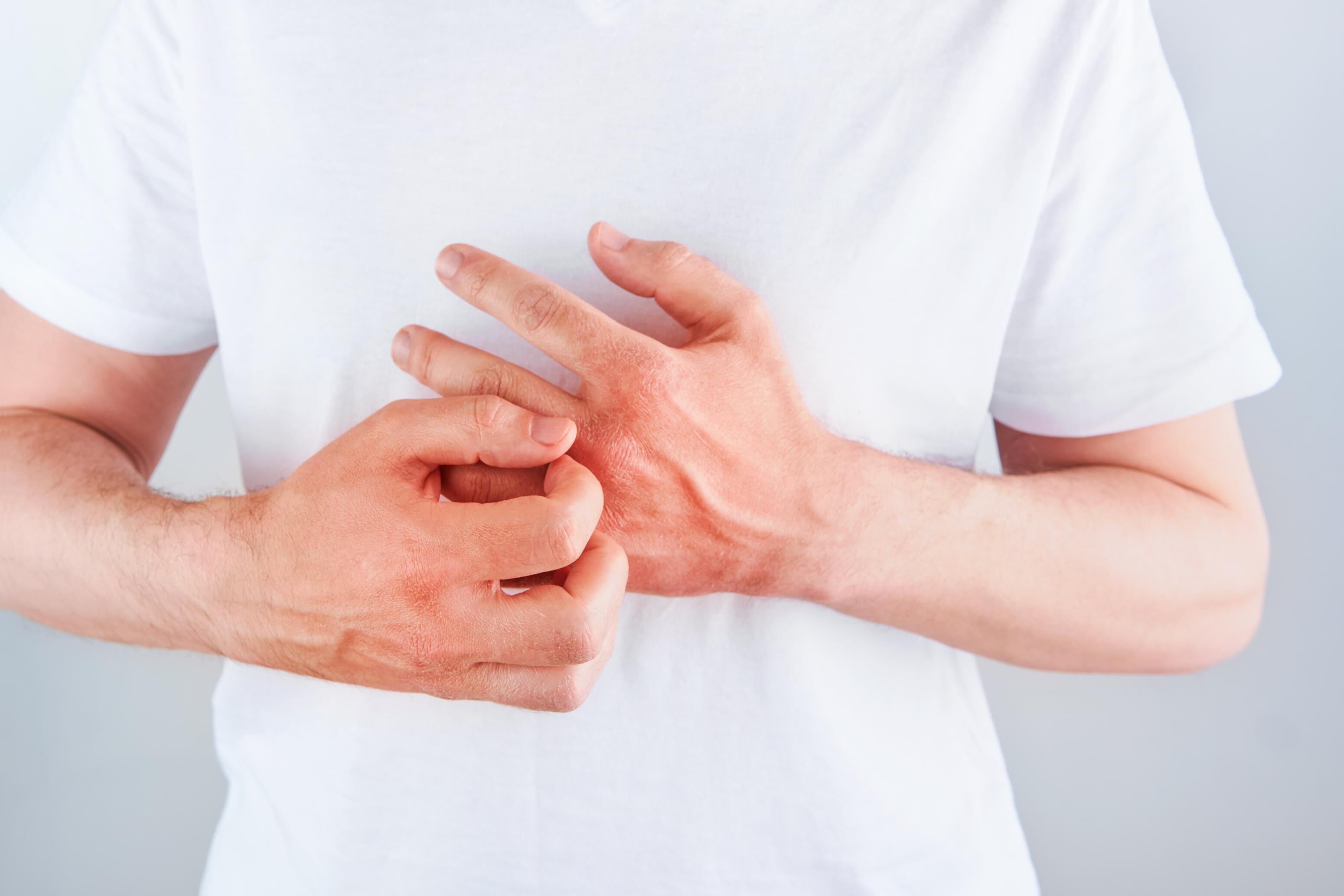 Eczéma : causes et traitements efficaces