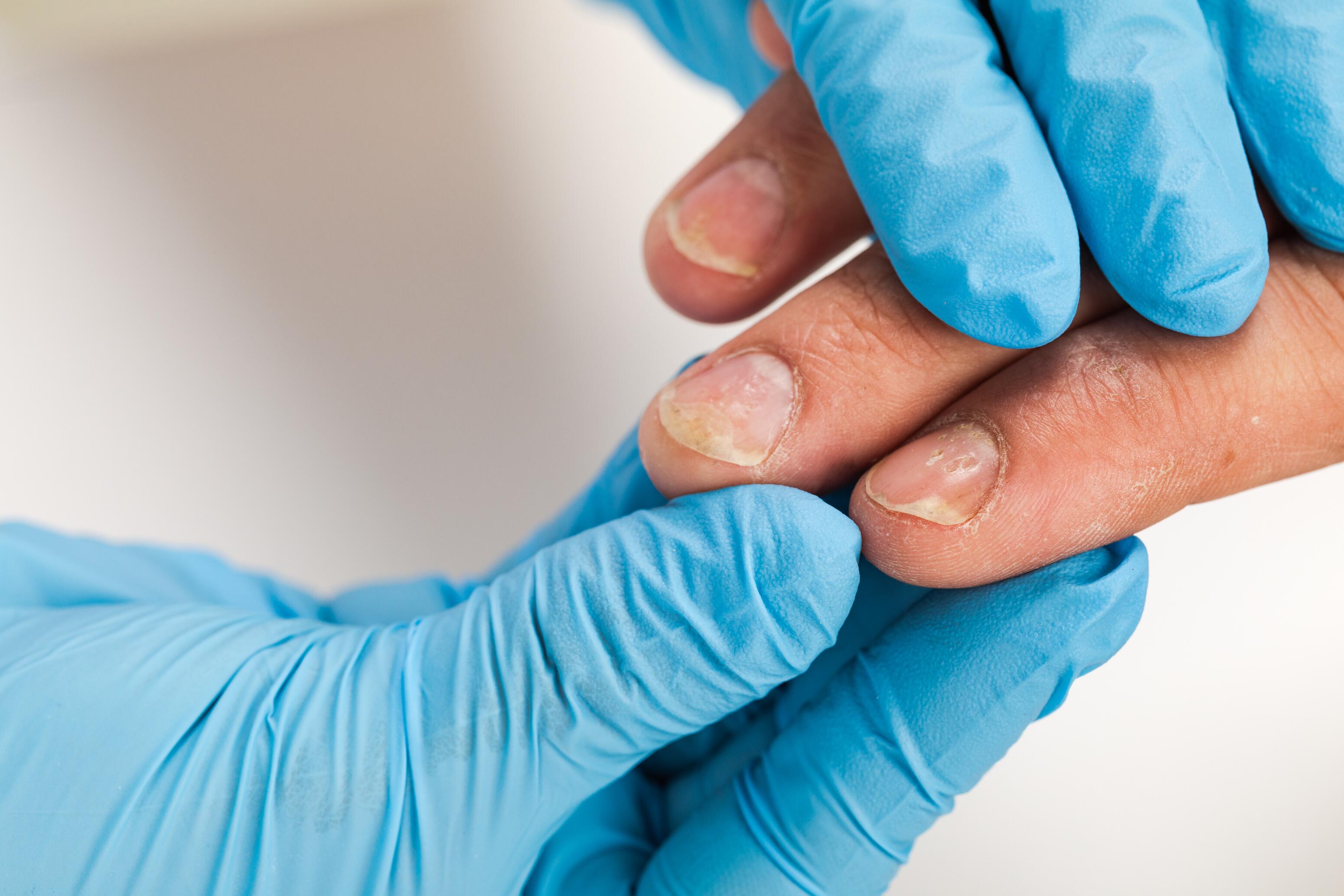 Psoriasis des ongles : symptômes et traitement du psoriasis unguéal ...