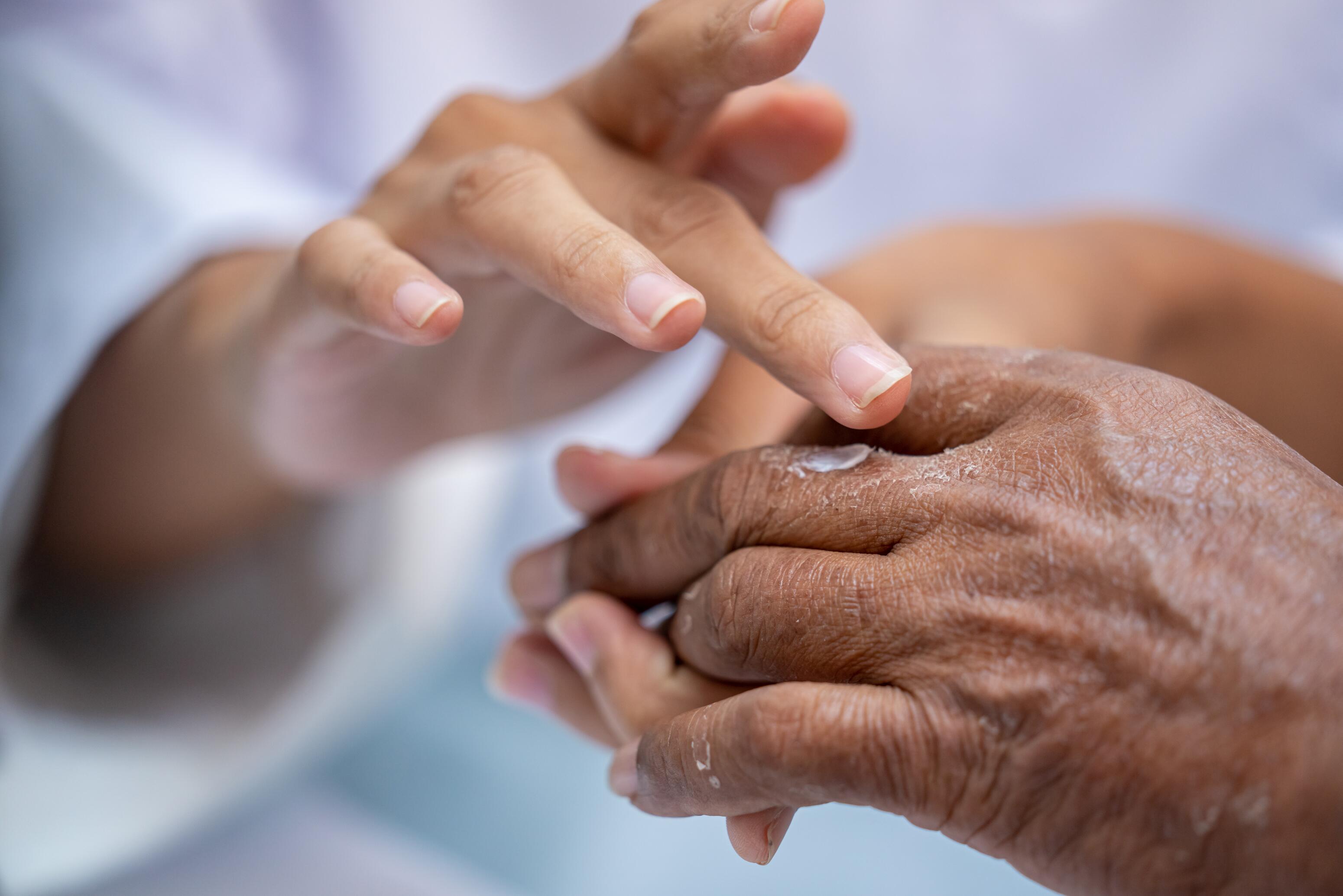 Le psoriasis est-il contagieux ? | Laboratoires Dermatologiques Ducray