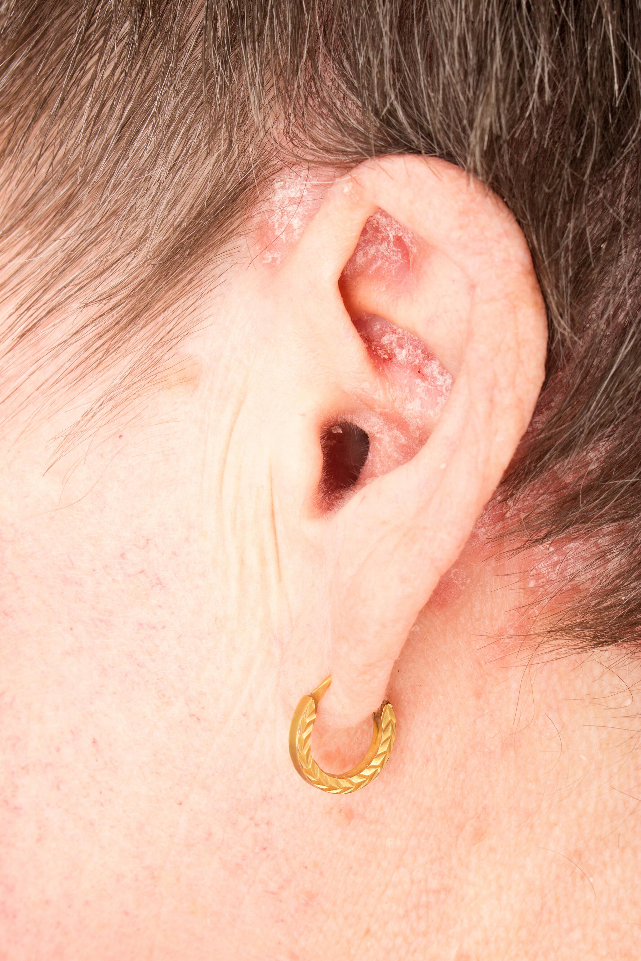 Psoriasis de l'oreille : comment le soulager ? | Ducray