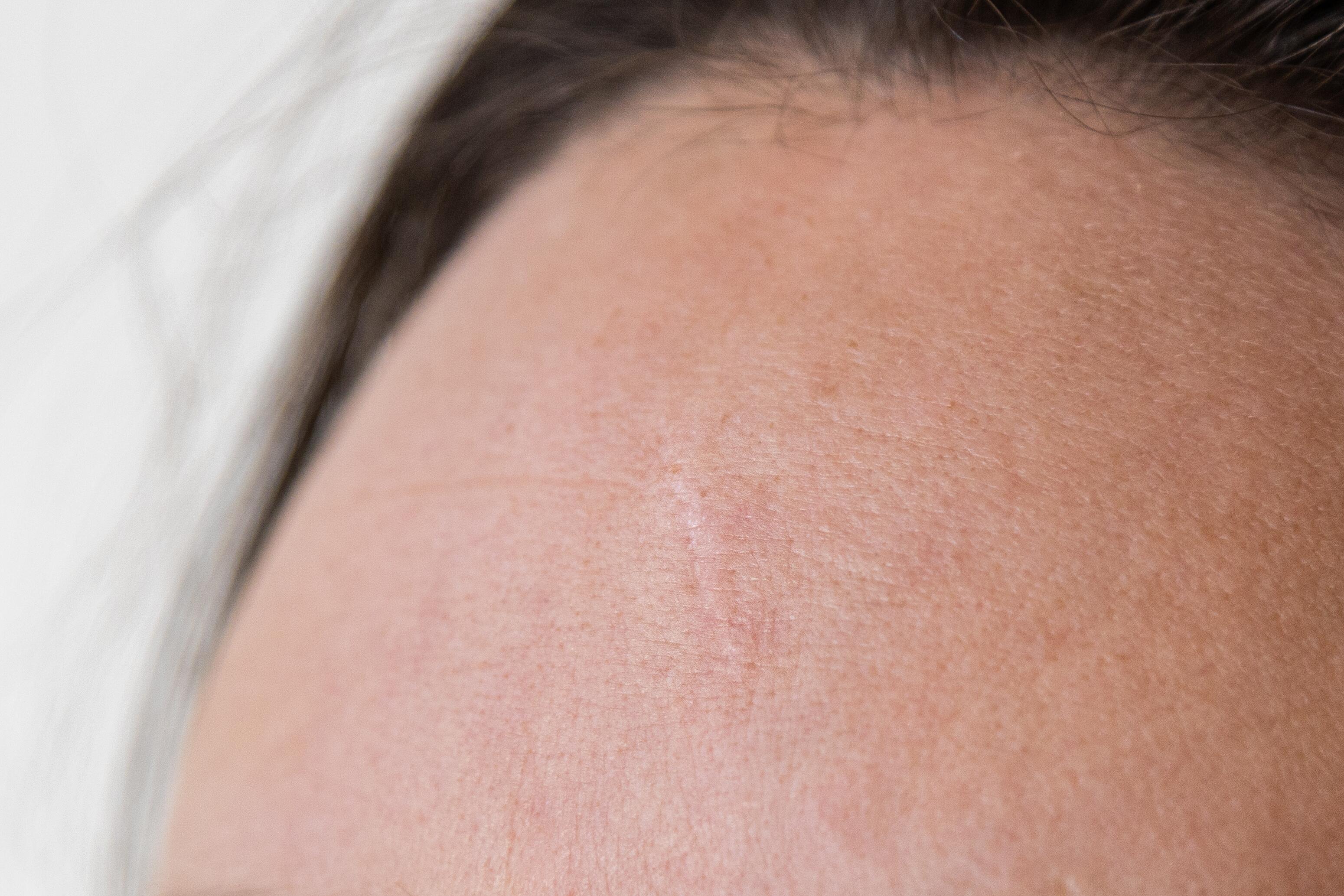 Cicatrice Visage : Causes, Types et Traitements