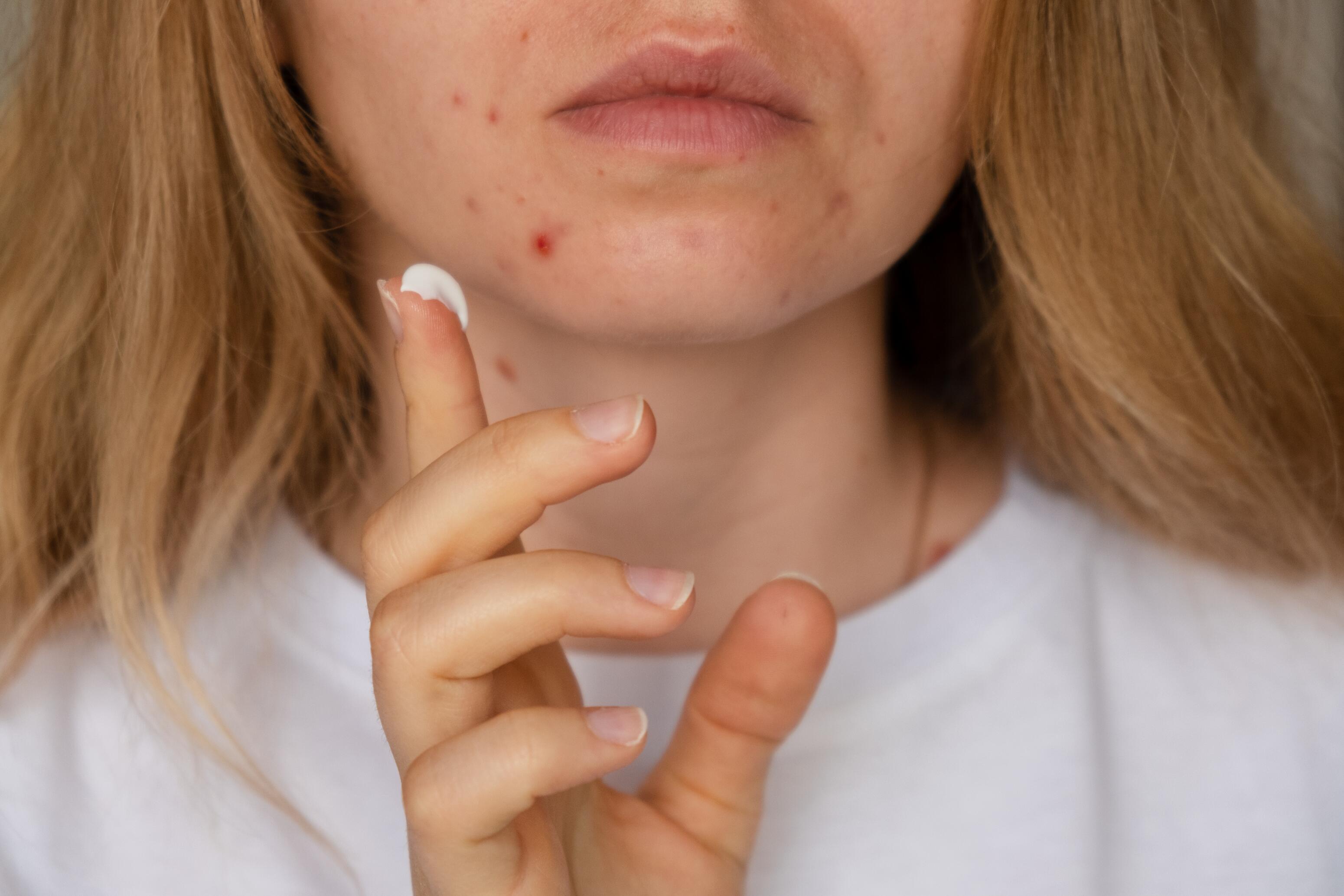 Cicatrice Visage : Causes, Types et Traitements