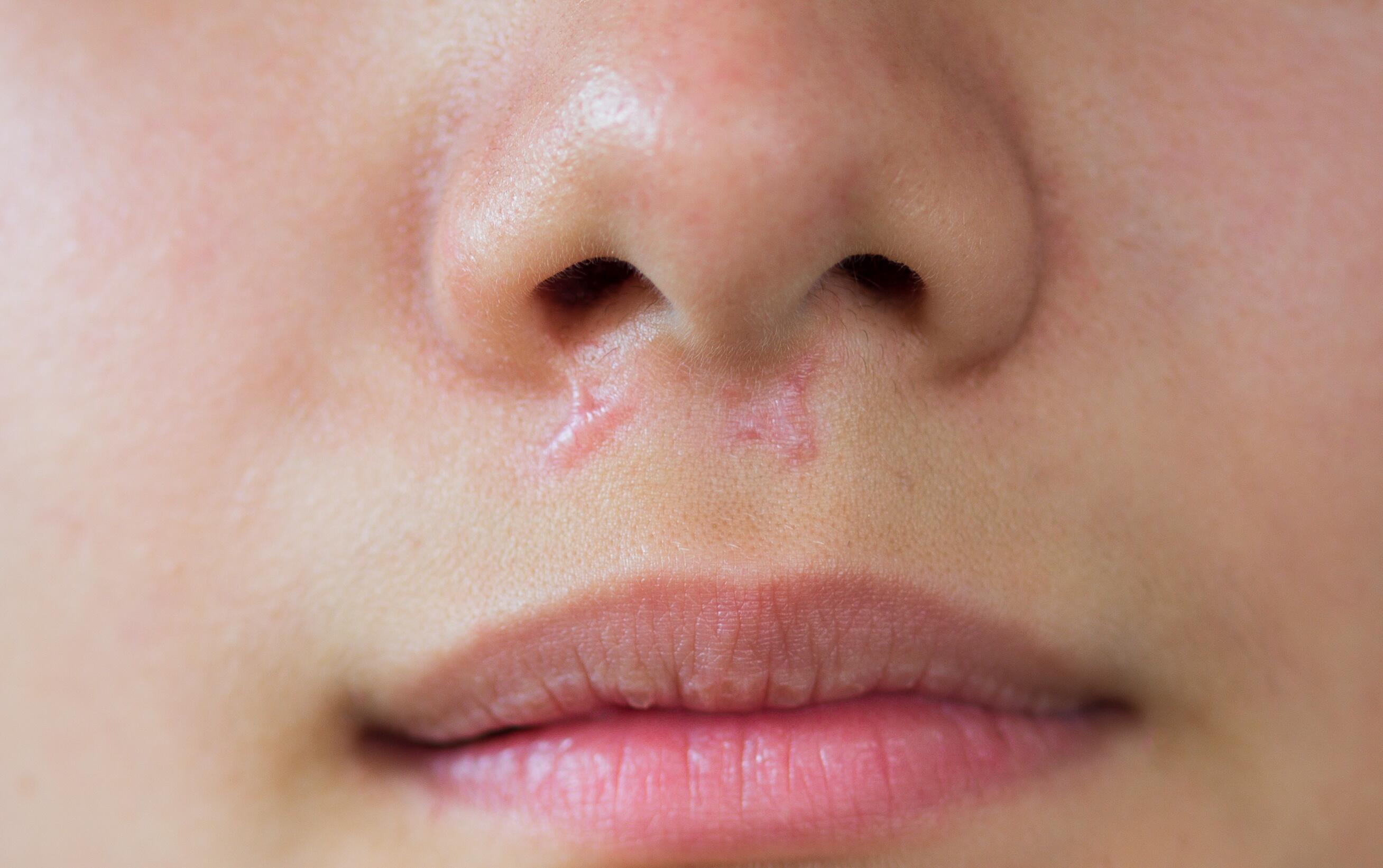 Cicatrice Visage : Causes, Types et Traitements