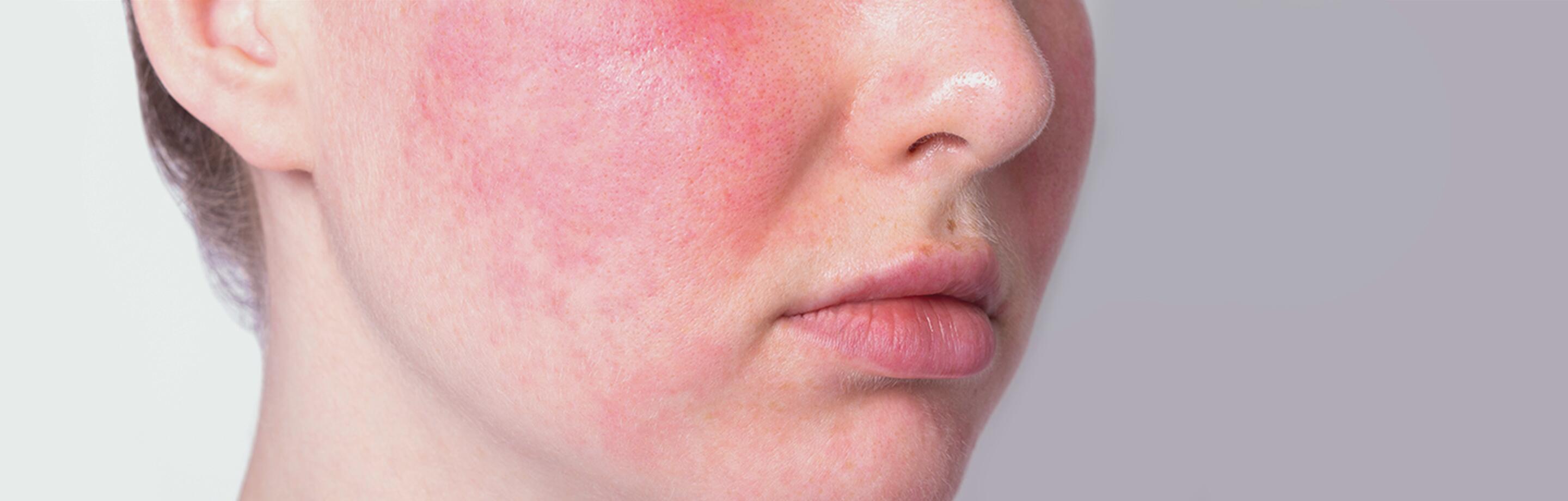 Rosacea Behandlung: Was Ihnen hilft | Eau Thermale Avène