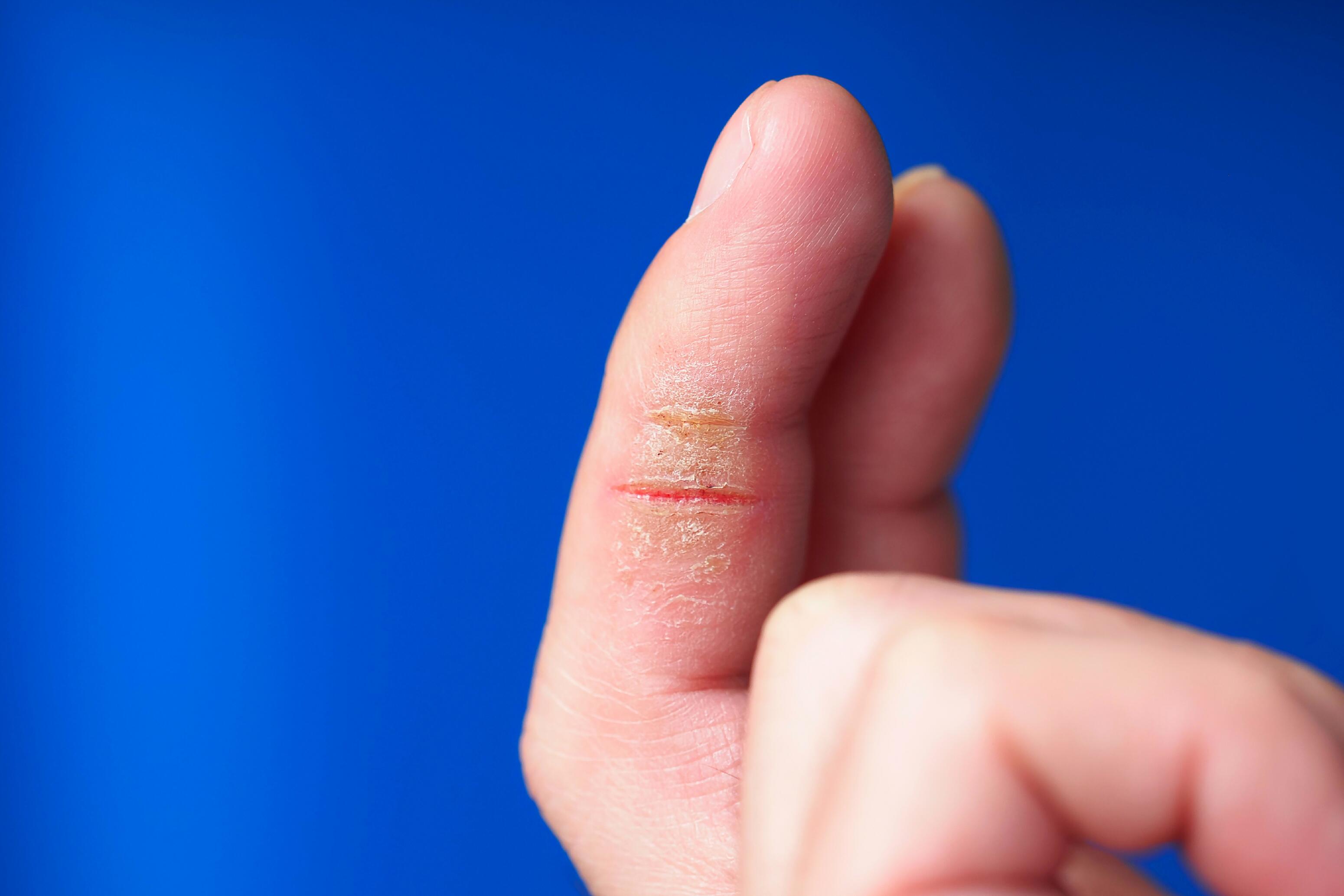 Dermatitis en manos y muñecas: síntomas, causas, tratamientos