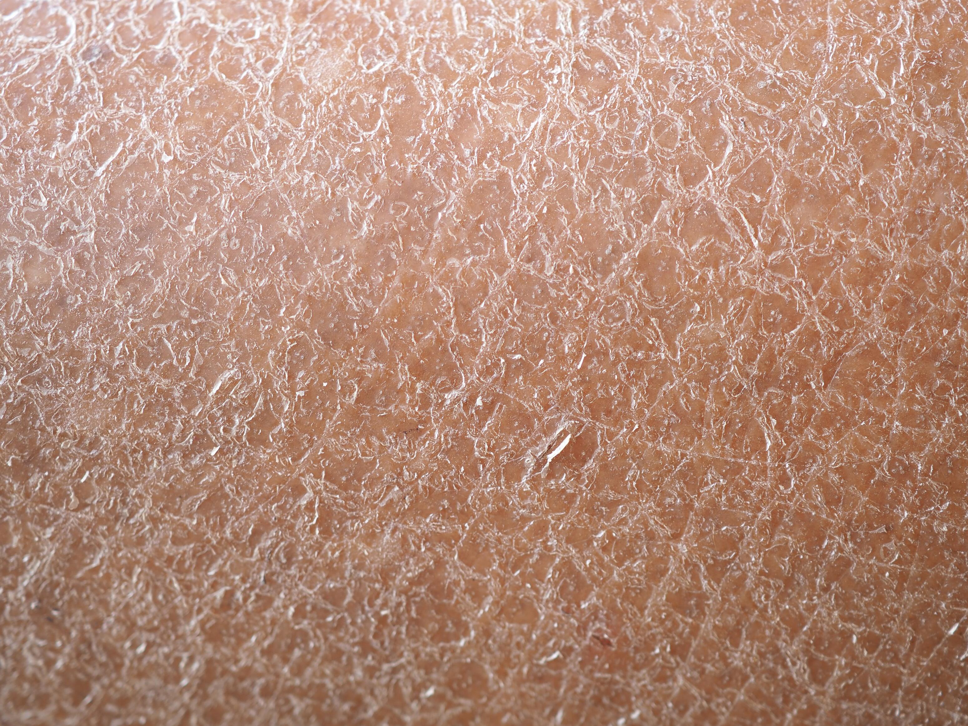 Todo sobre la ictiosis: causas, síntomas y tratamientos