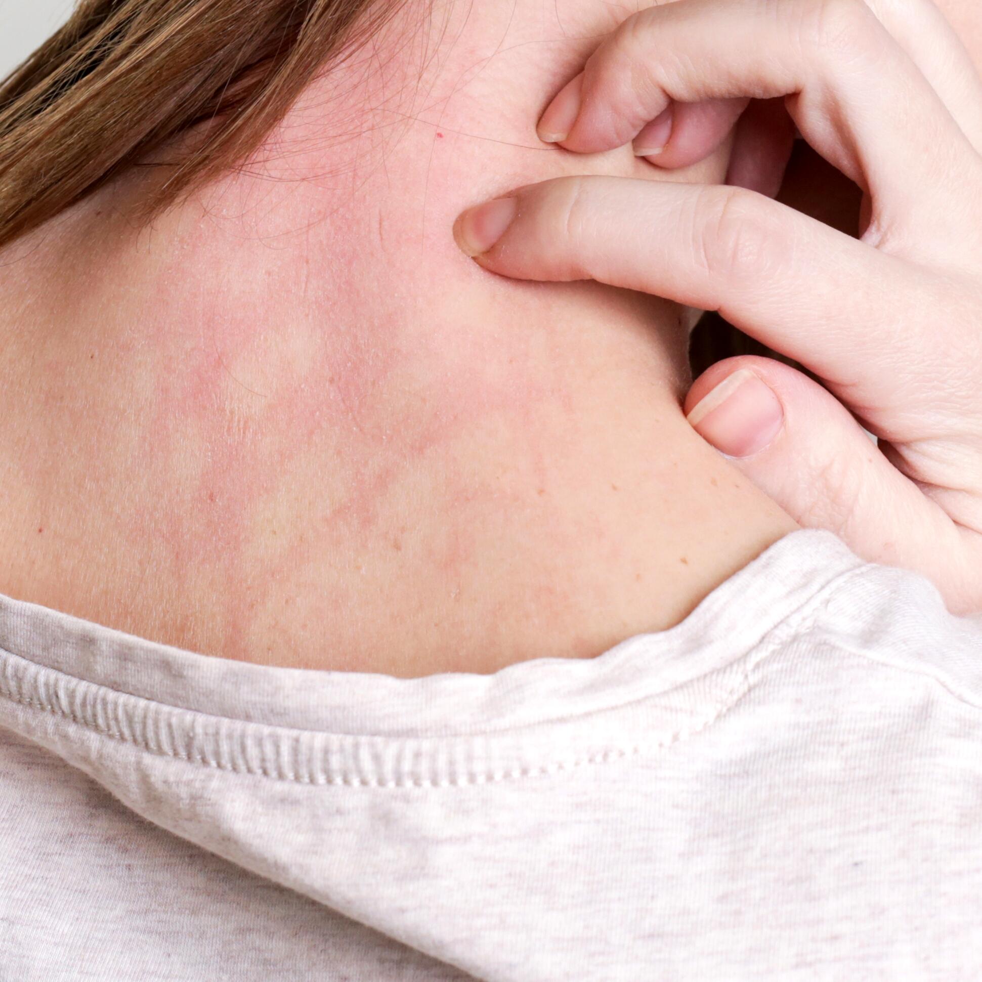 Skin rashes and healing scars on your skin | Eau Thermale Avène