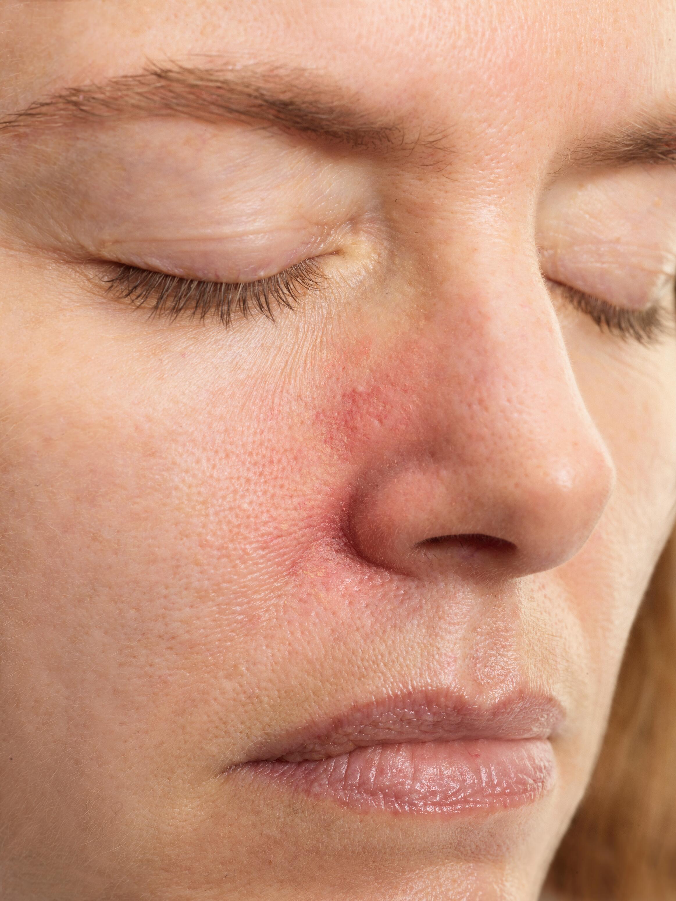 Dermite séborrhéique sur le visage : causes et traitement | Ducray