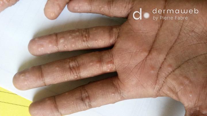 Managing pimples on dry skin: Causes and effective treatments