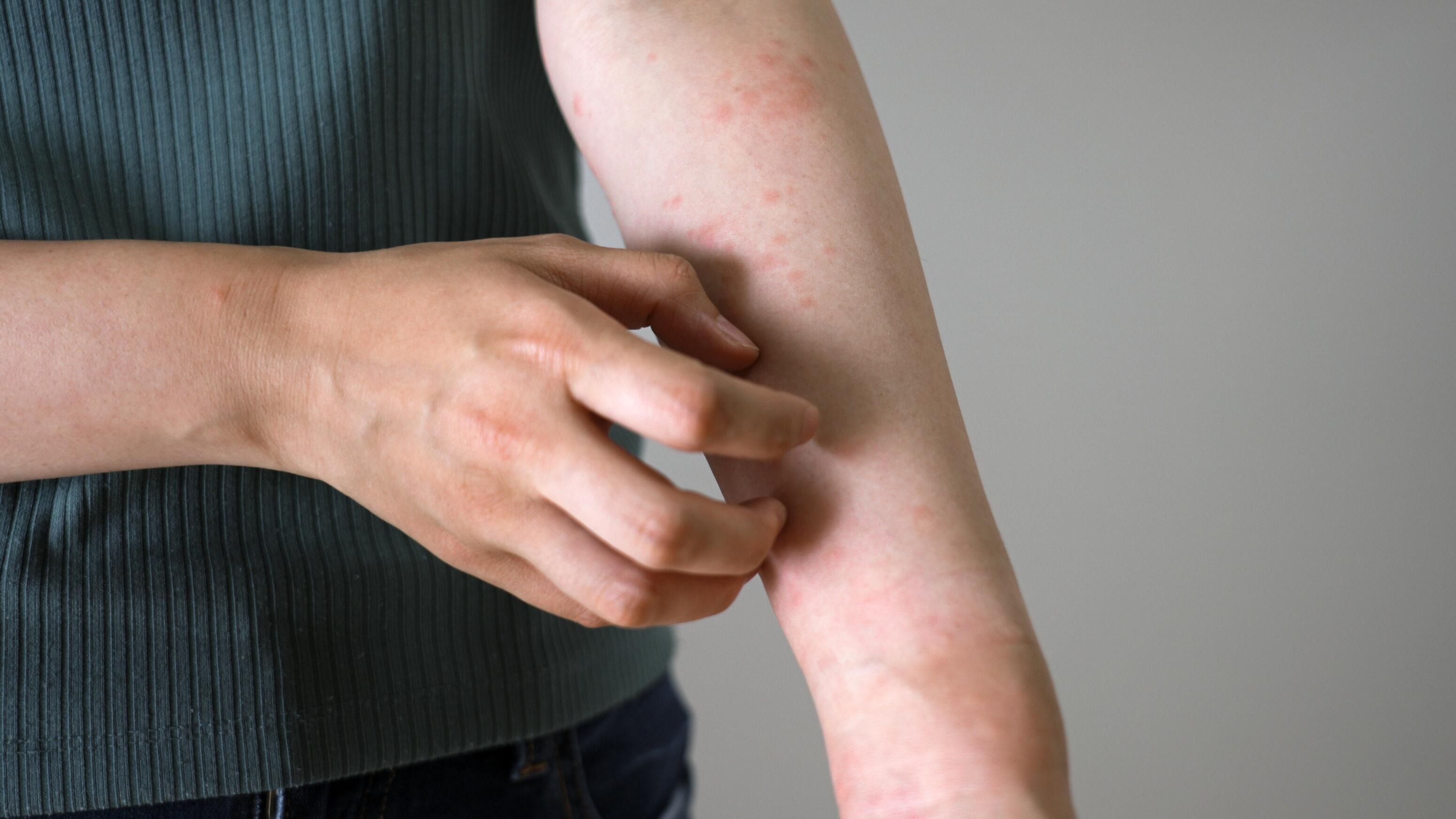 Polymorphous light eruption or sun allergy: how do I get relief? | Ducray
