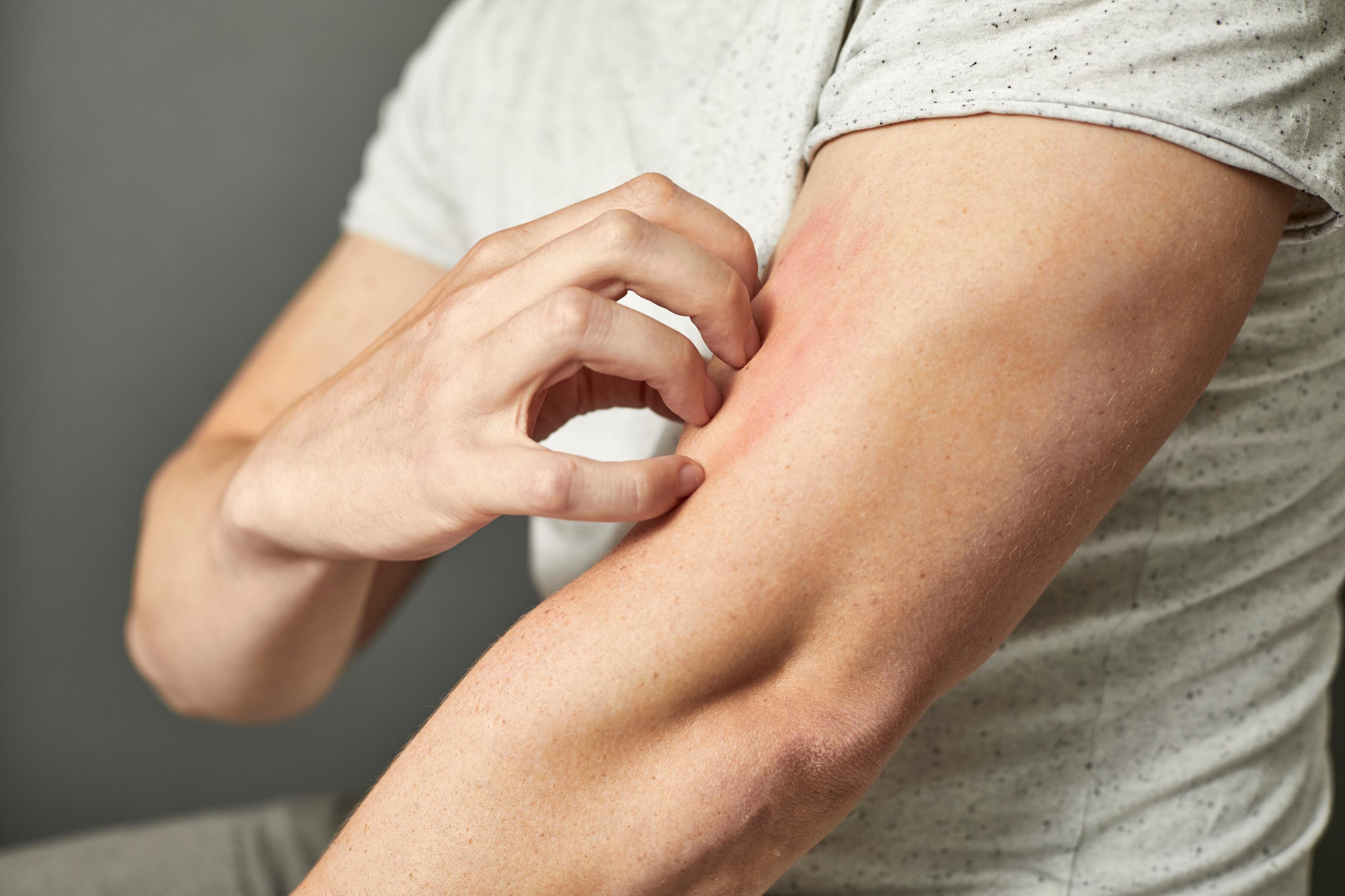 Comichão, prurido: causas, sintomas e tratamento | Laboratórios Ducray