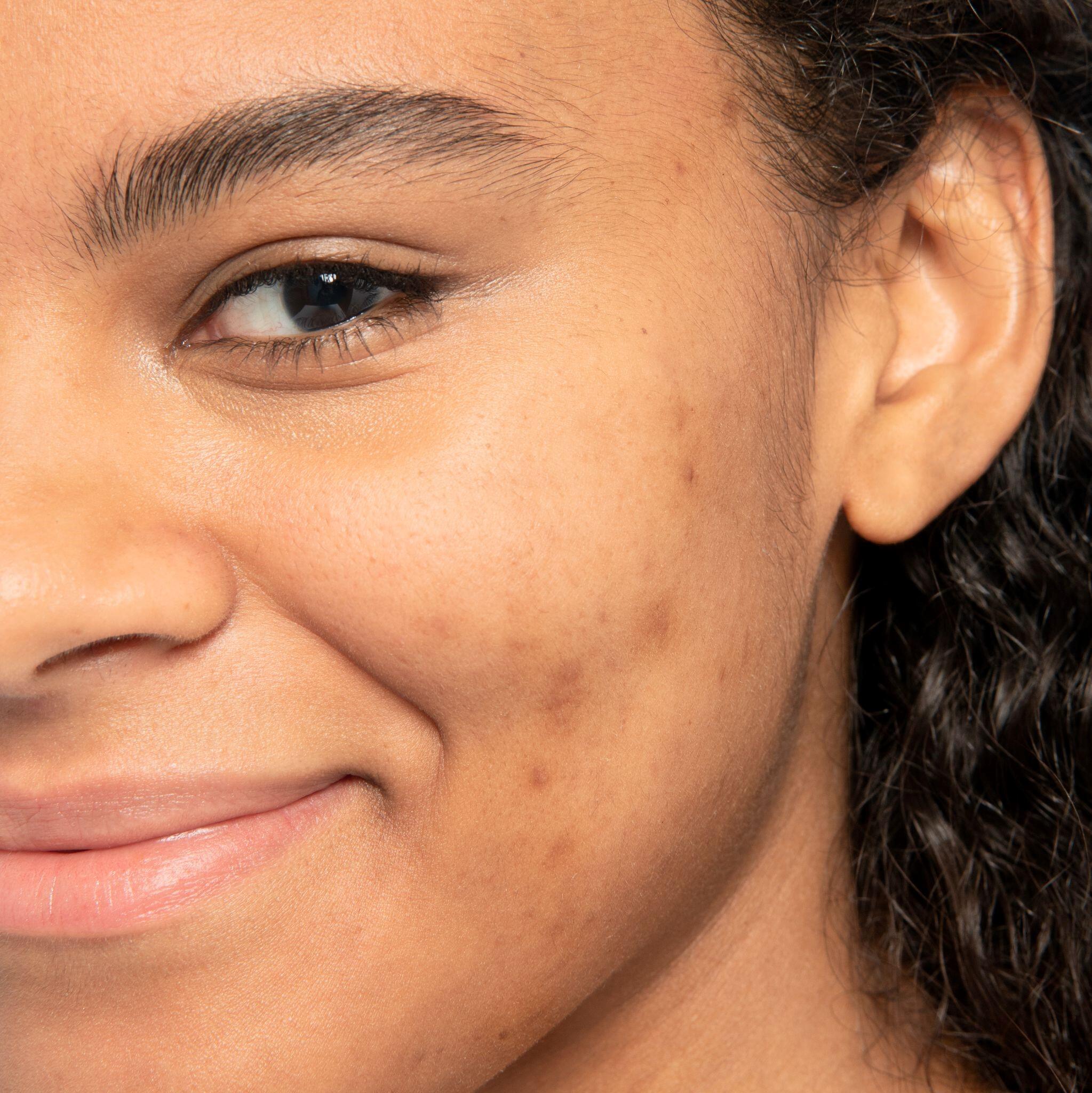 Les taches brunes sur le visage | Ducray