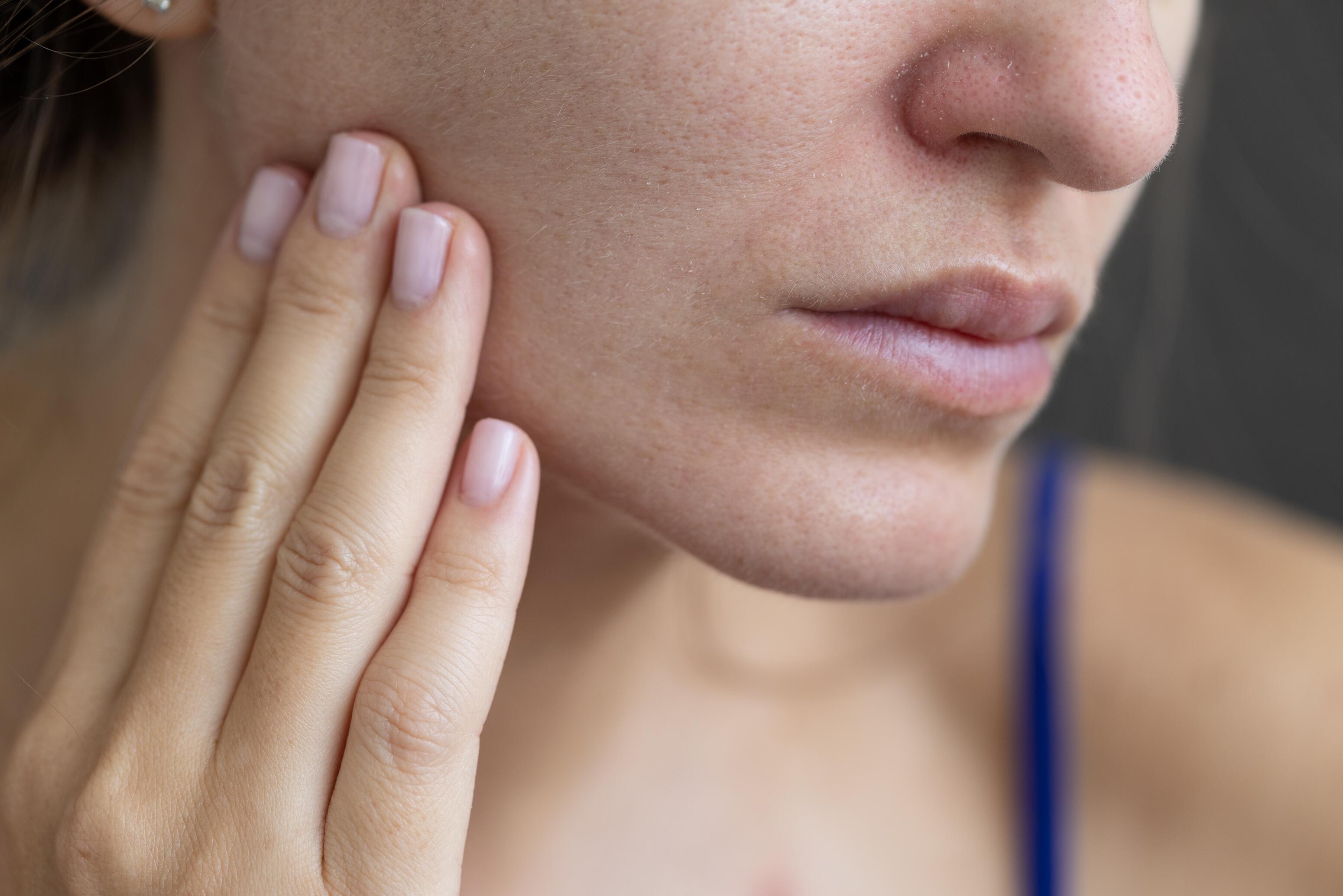 Managing pimples on dry skin: Causes and effective treatments