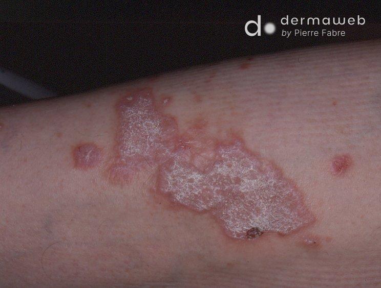 Soigner les plaques de peau sèche sur le corps : Guide Complet