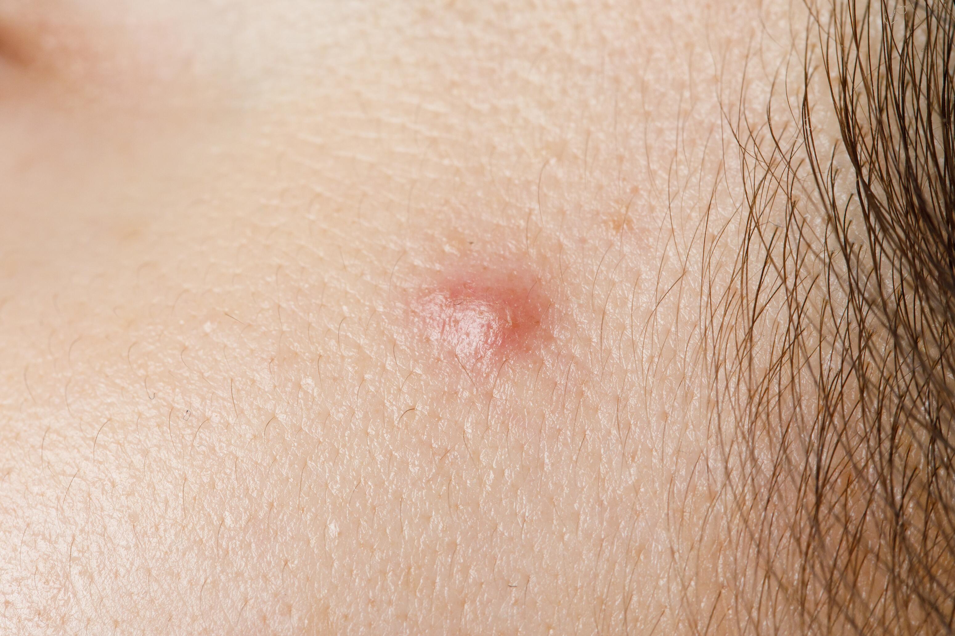 Managing pimples on dry skin: Causes and effective treatments