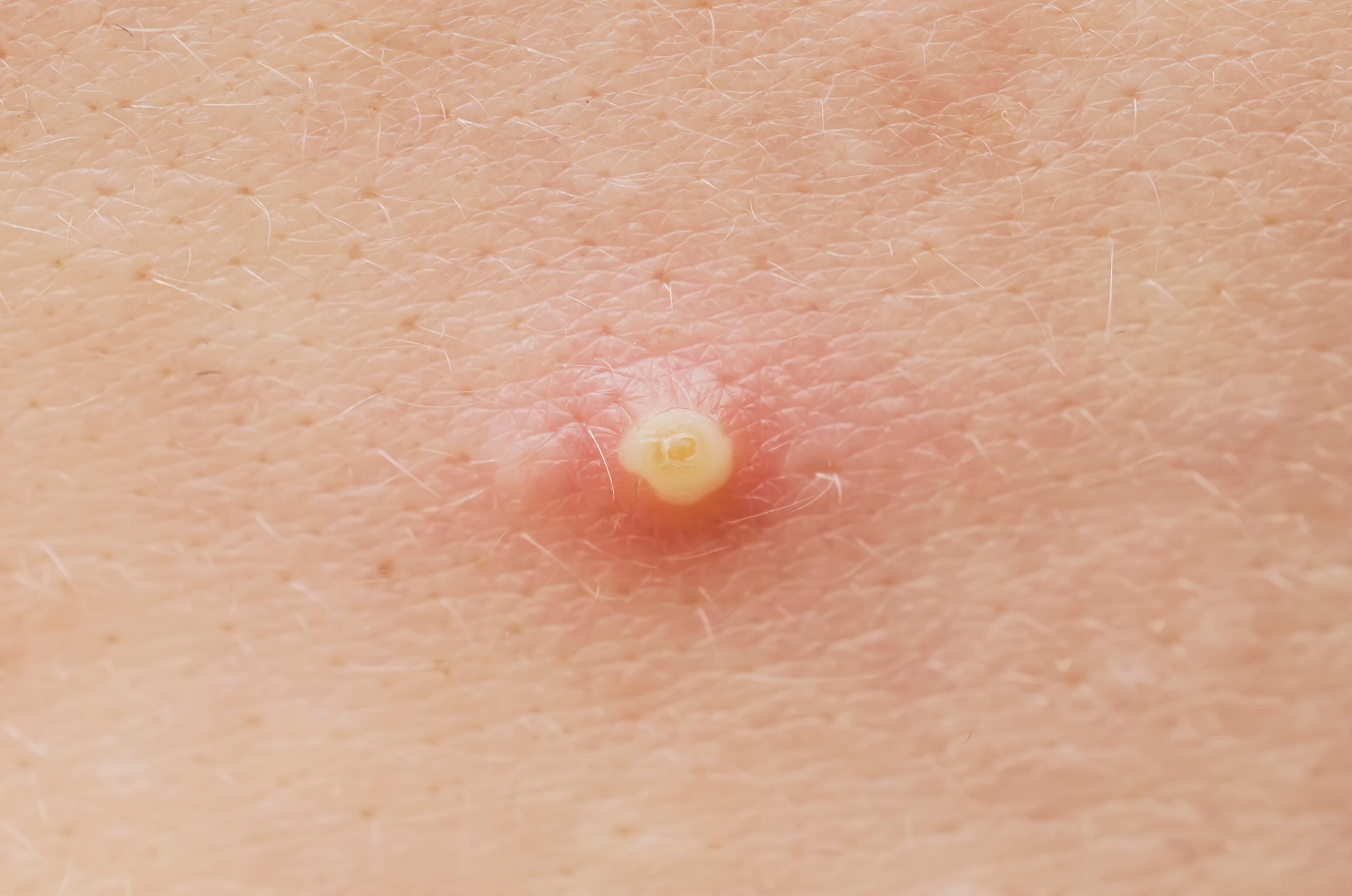 Managing pimples on dry skin: Causes and effective treatments