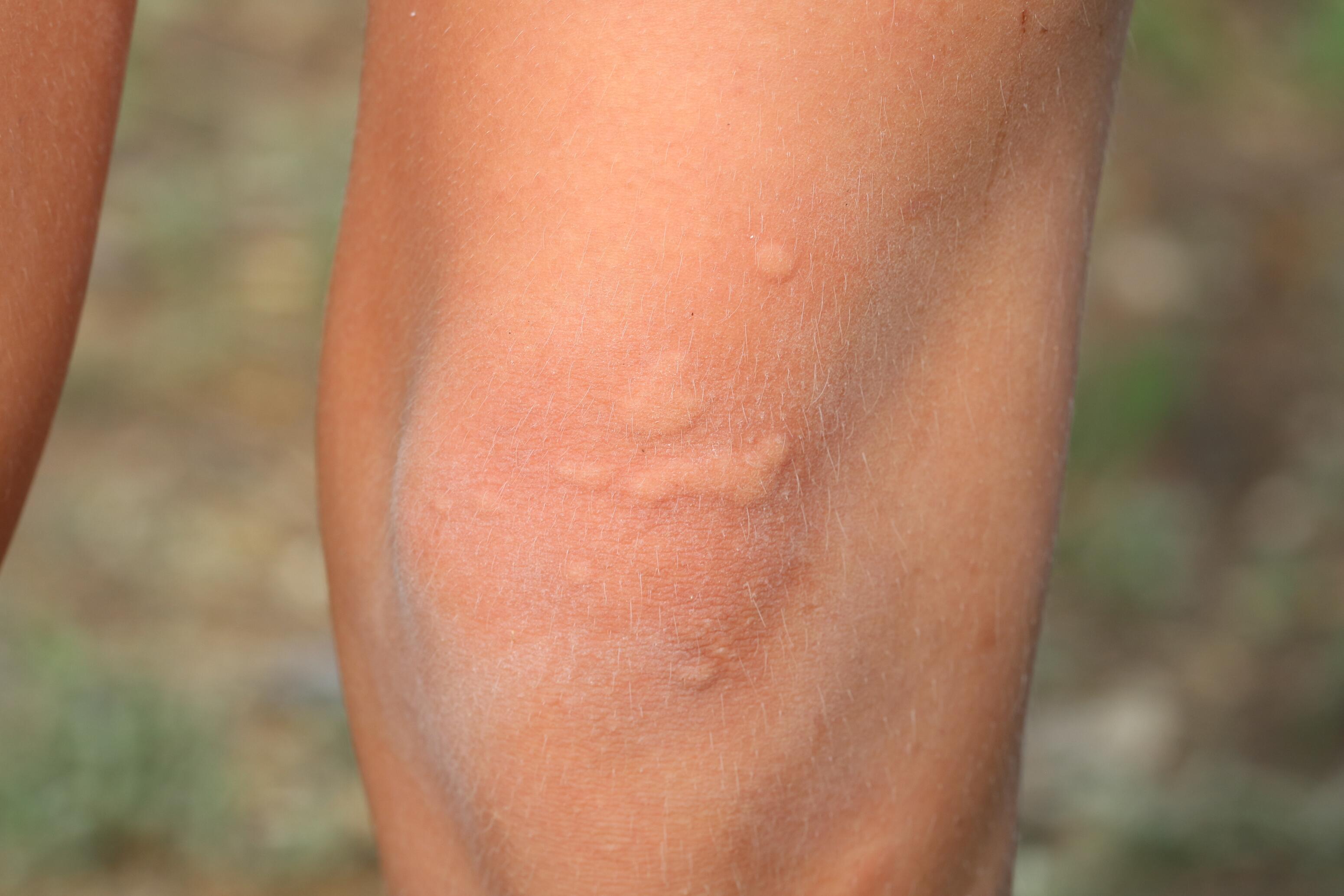 Eczéma et Urticaire : Différences et soins | A-Derma