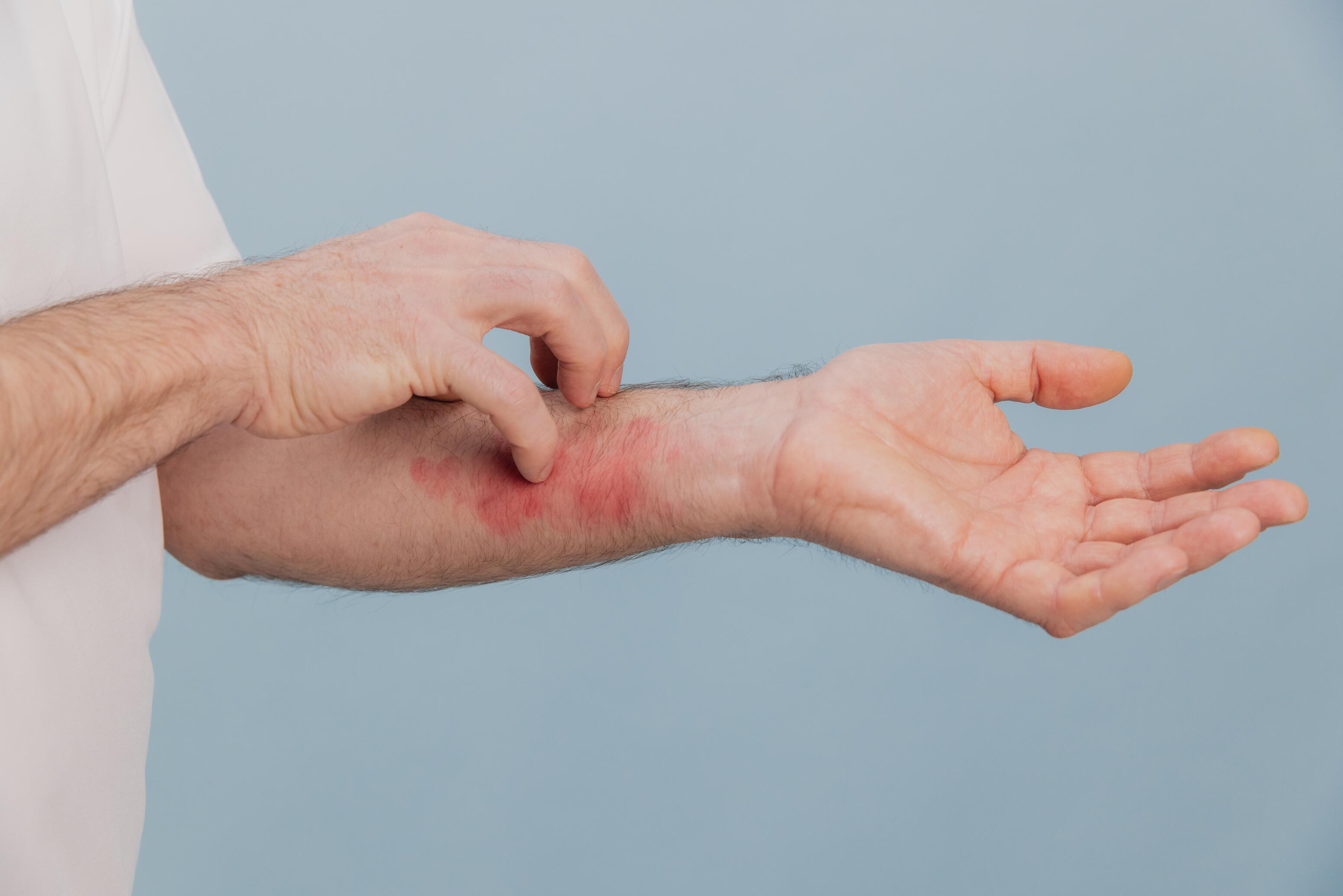 Symptômes de l'Eczéma : Reconnaître et comprendre | | A-Derma