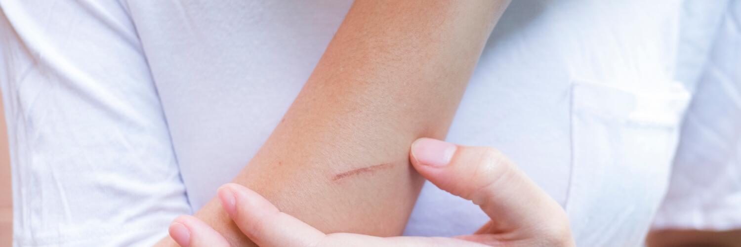 Cicatrice : Guide Complet pour Prévenir et Traiter