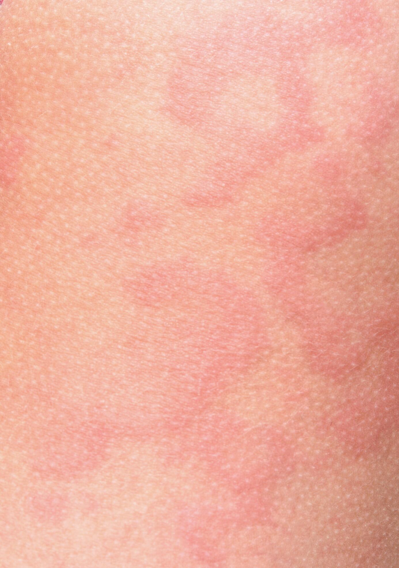 Alergia al sol: causas y soluciones | Eau Thermale Avène